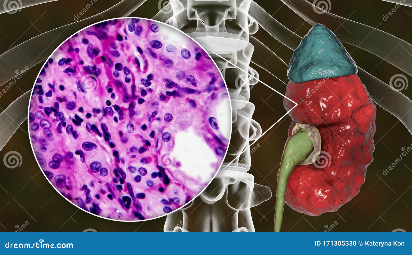 Chronic Pyelonephritis, Illustration and Light Micrograph Stock ...