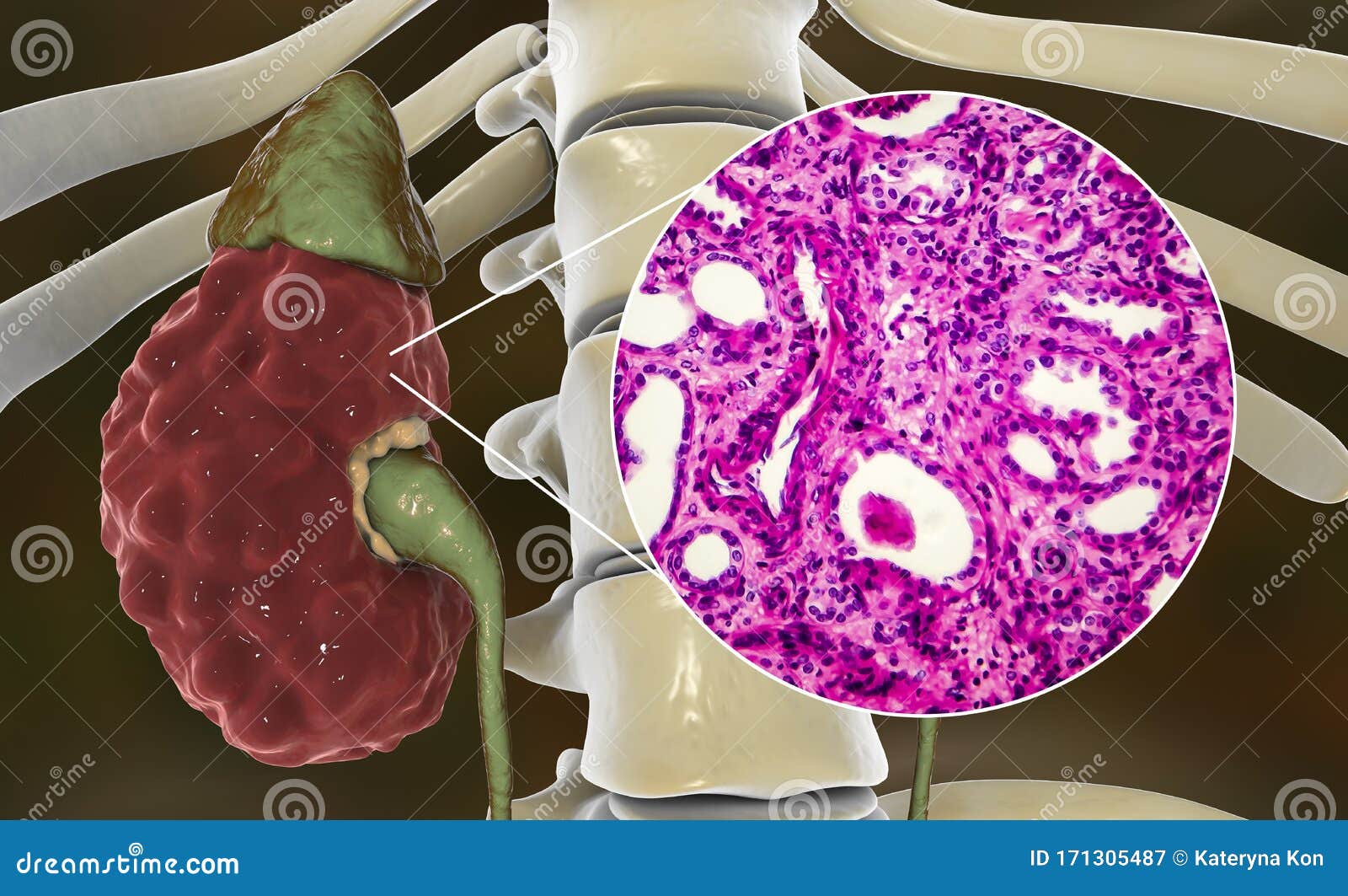Chronic Pyelonephritis, Illustration and Light Micrograph Stock ...