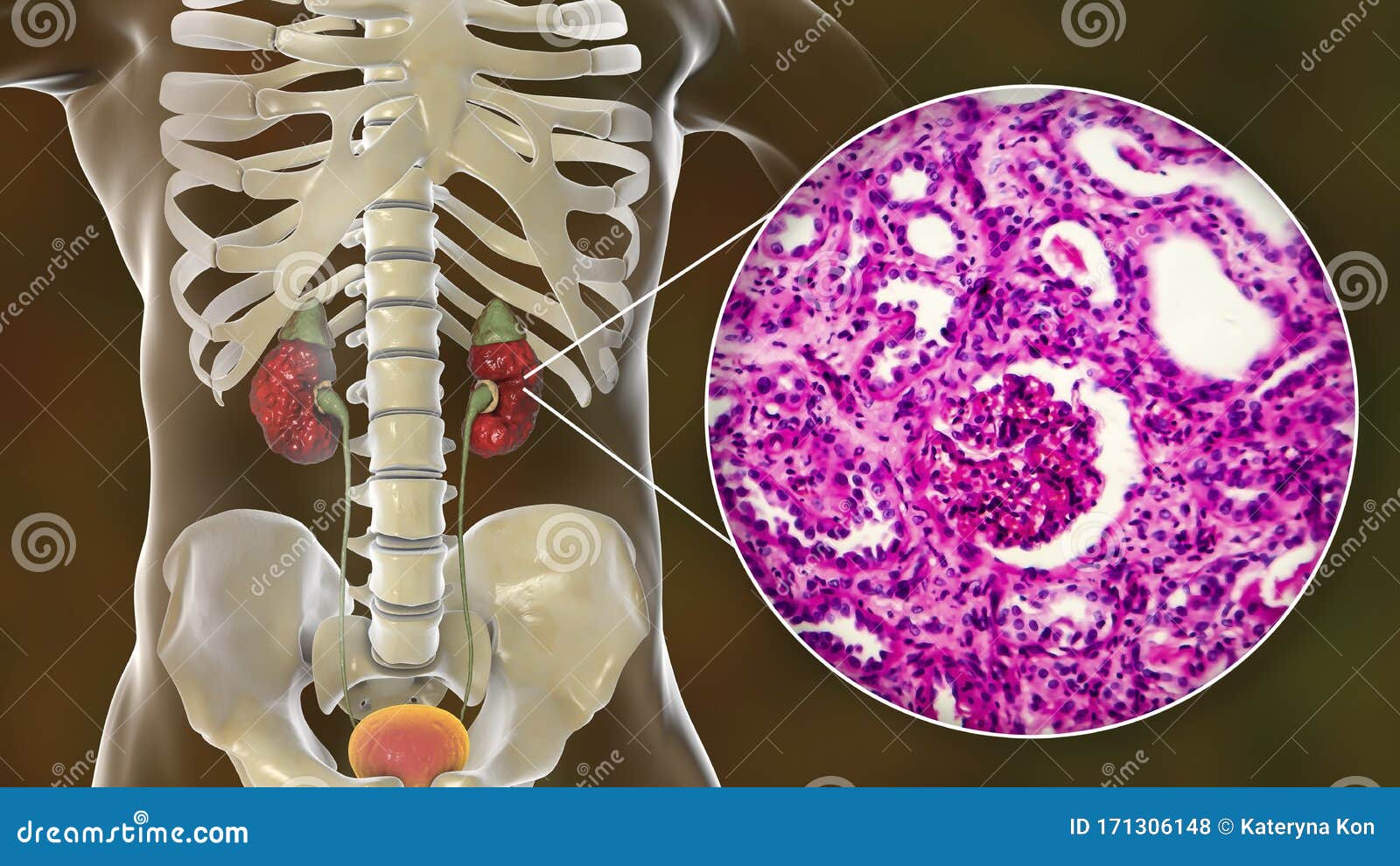 Chronic Pyelonephritis, Illustration and Light Micrograph Stock ...