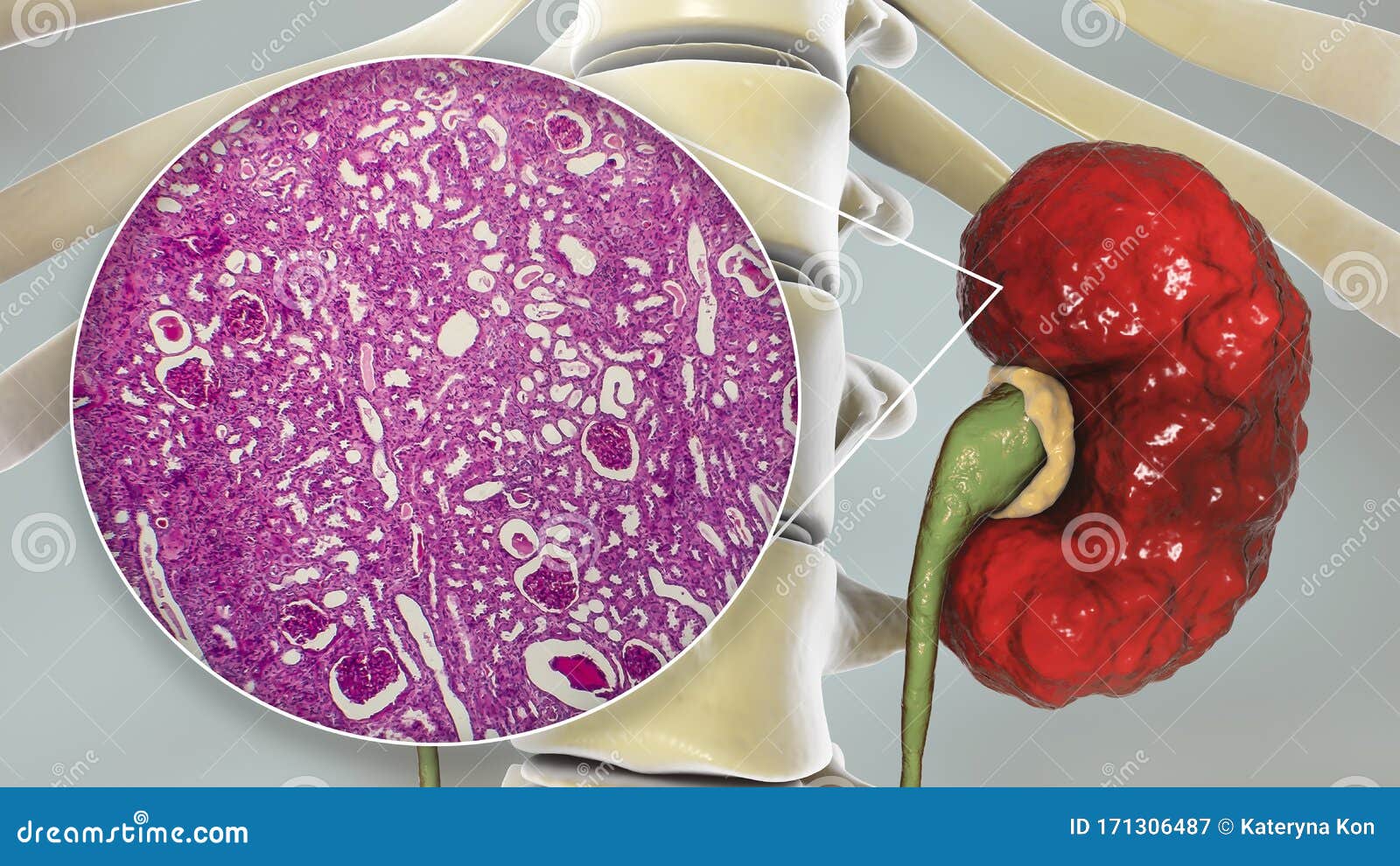 Chronic Pyelonephritis, Illustration and Light Micrograph Stock ...