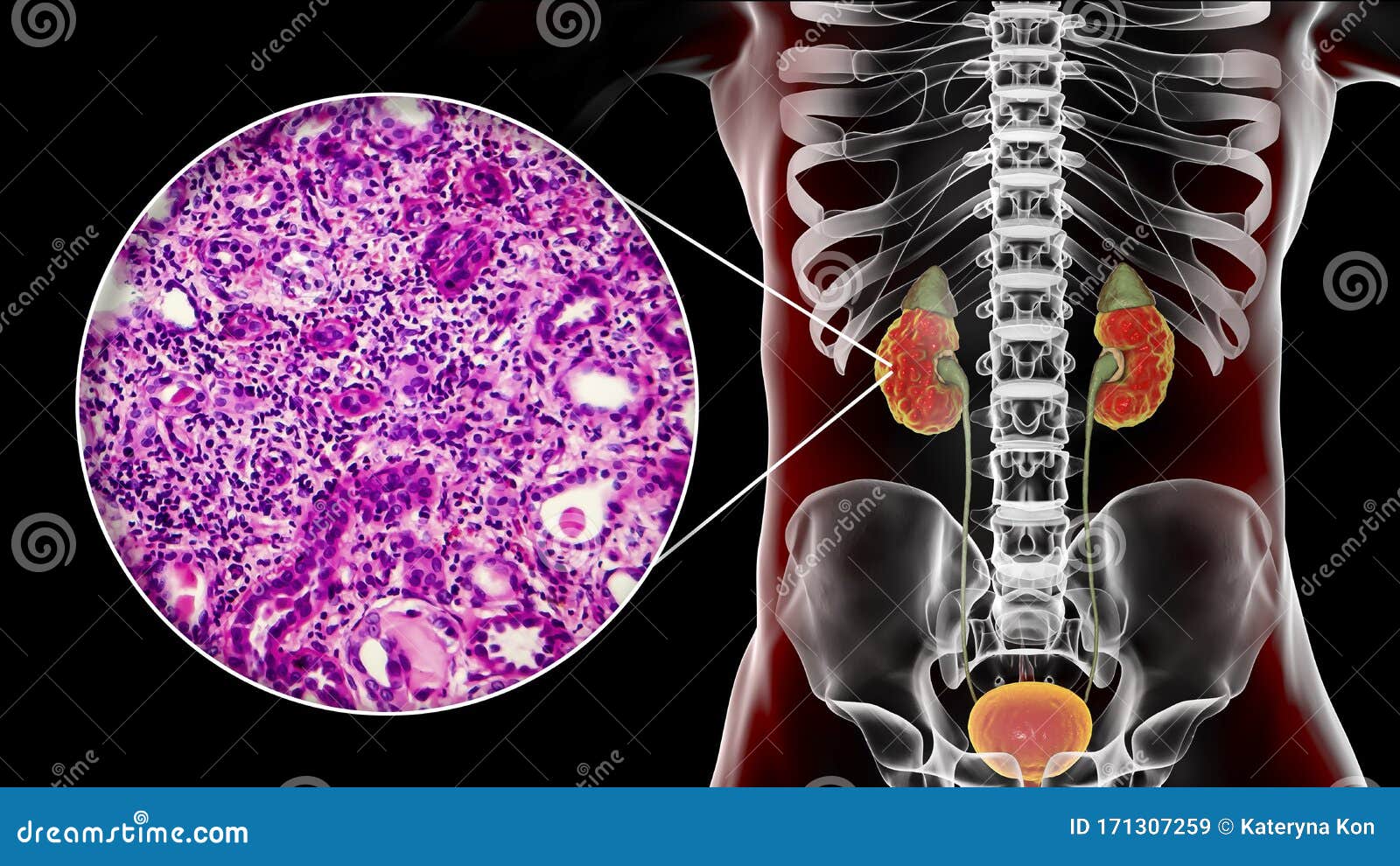 Chronic Pyelonephritis, Illustration and Light Micrograph Stock ...