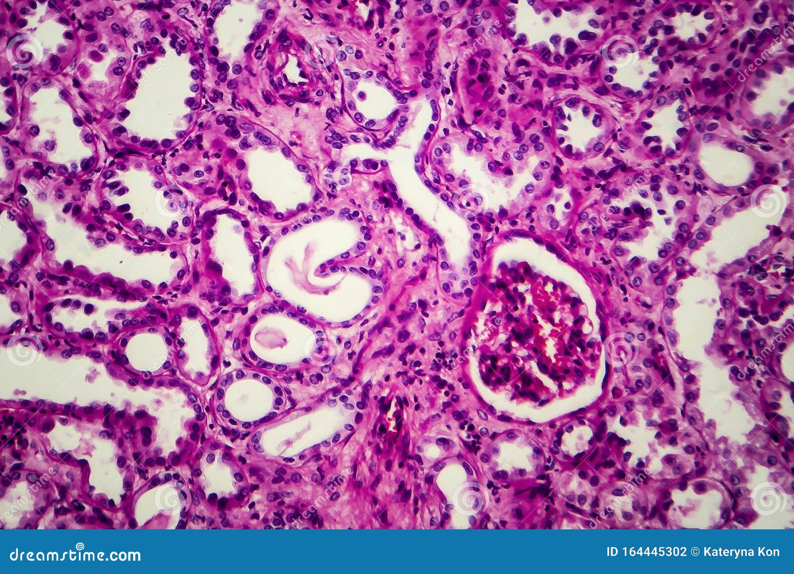 Chronic Pyelonephritis, Light Micrograph Stock Photo - Image of ...