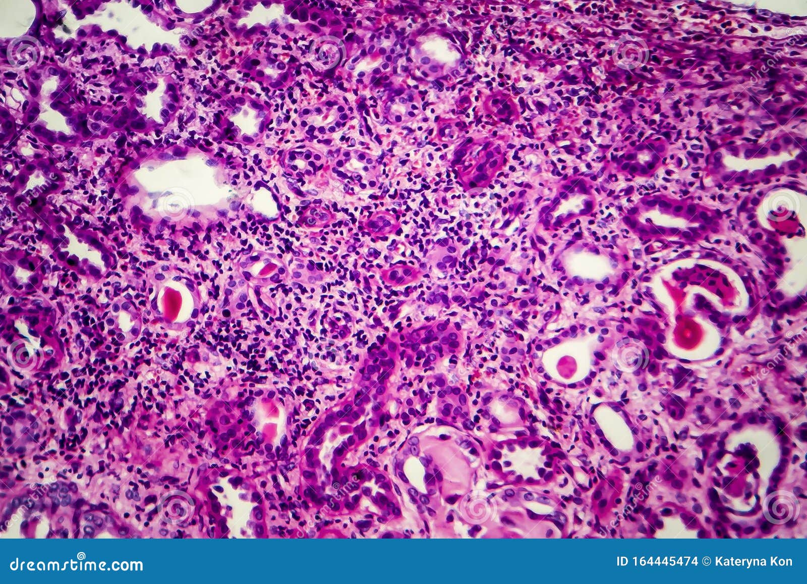 Chronic Pyelonephritis, Light Micrograph Stock Photo - Image of urinary ...