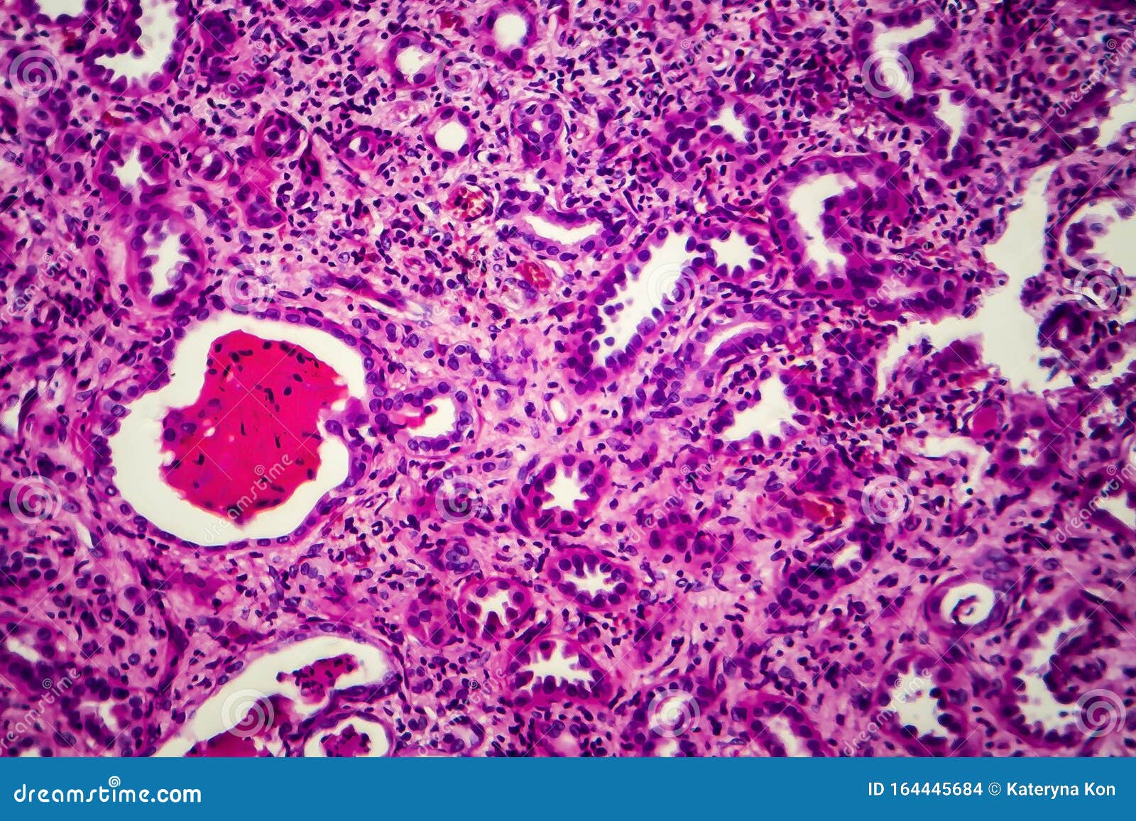 Histopathology Kidneyacute And Chronic Pyelonephritis