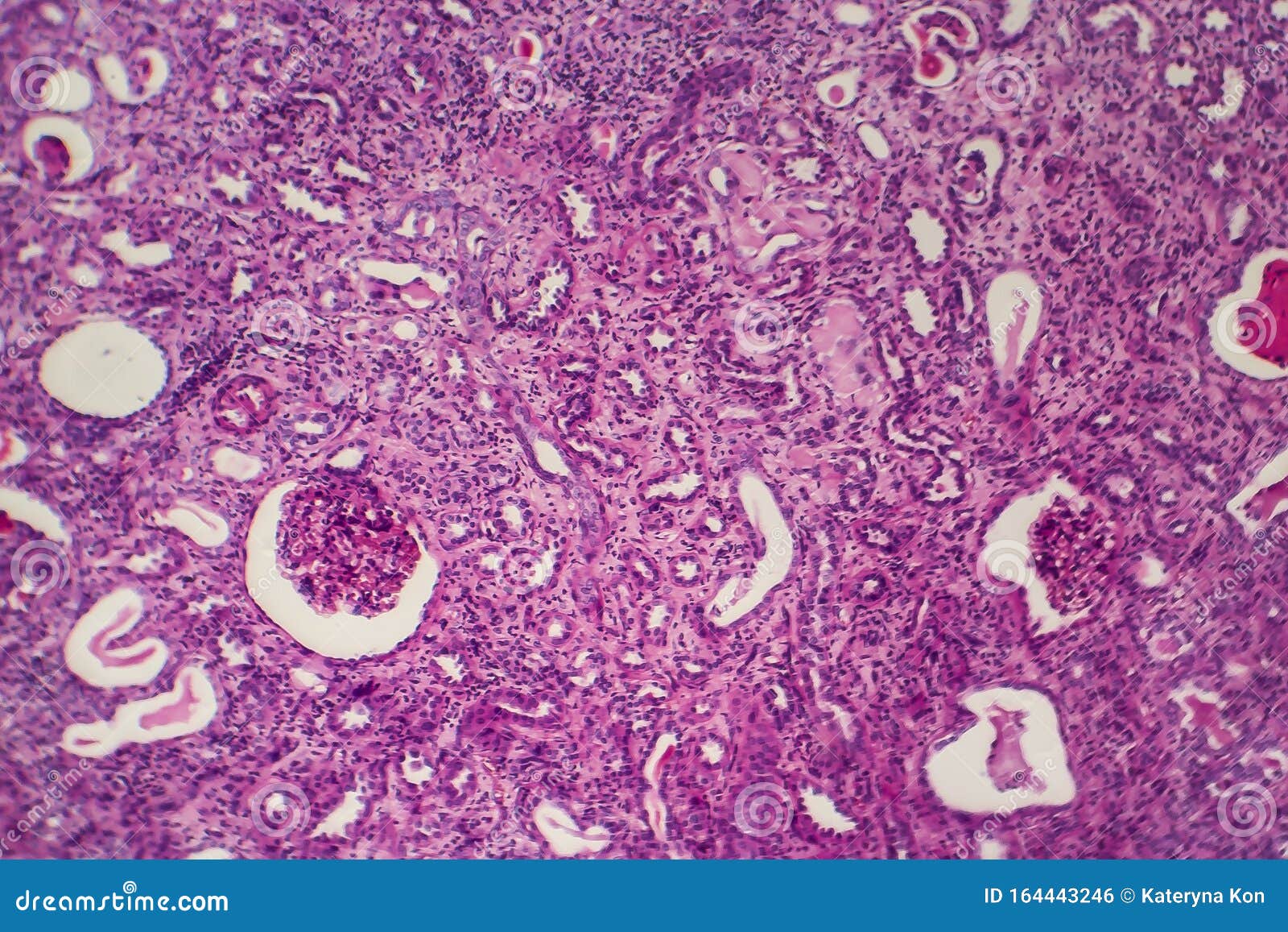 Chronic Pyelonephritis, Light Micrograph Stock Photo - Image of ...