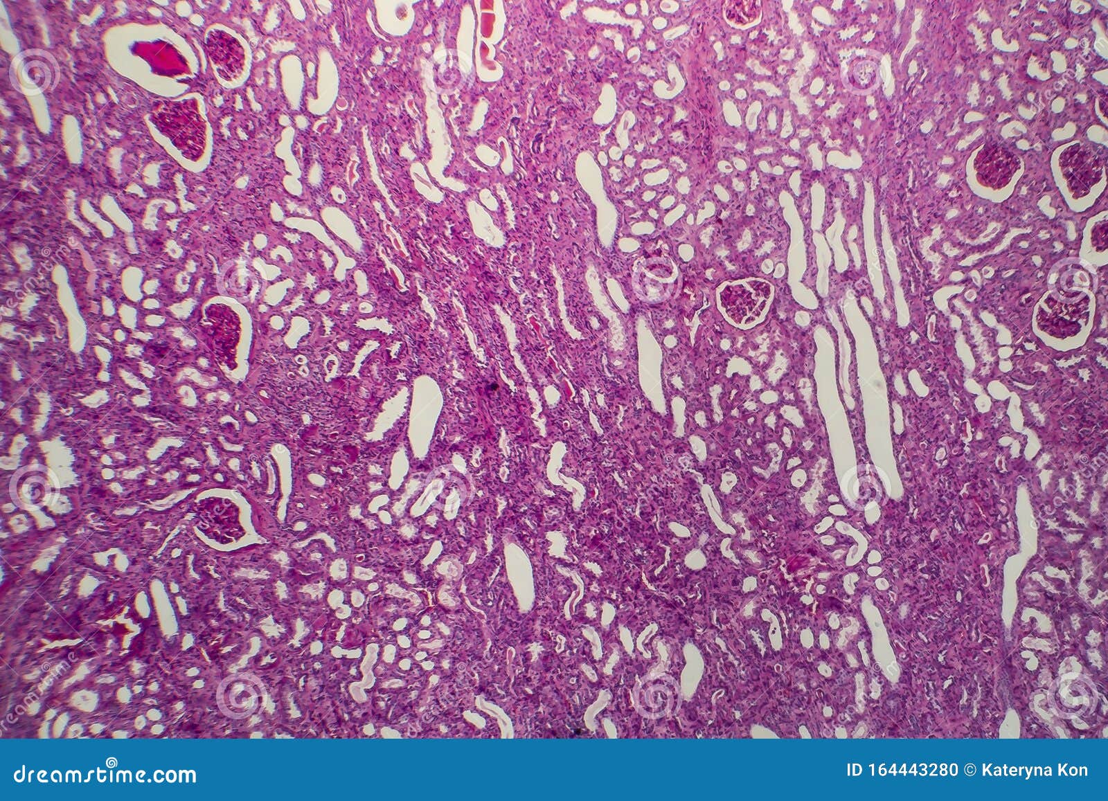 Histopathology Kidneyacute And Chronic Pyelonephritis