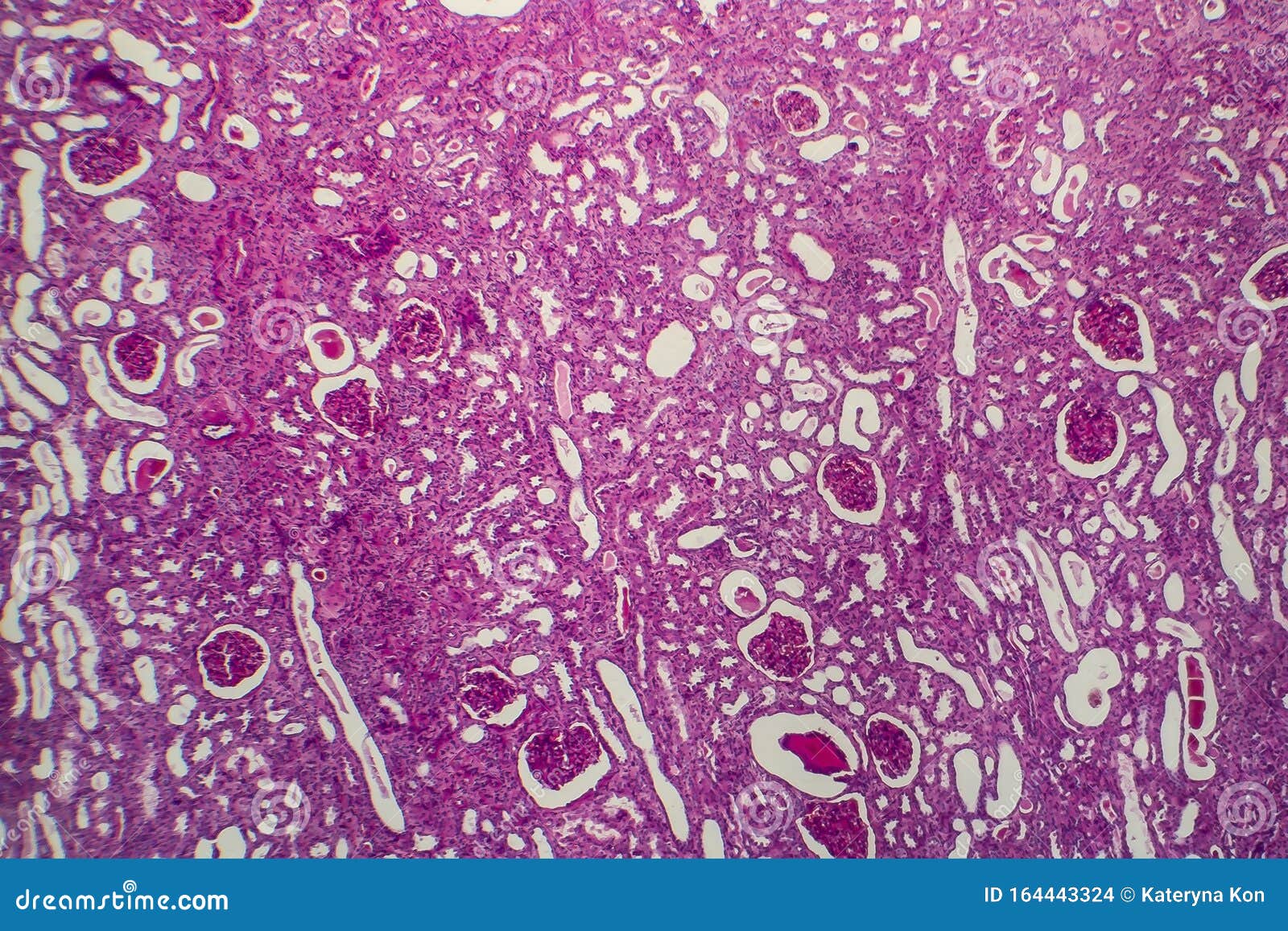 Chronic Pyelonephritis, Light Micrograph Stock Photo - Image of ...