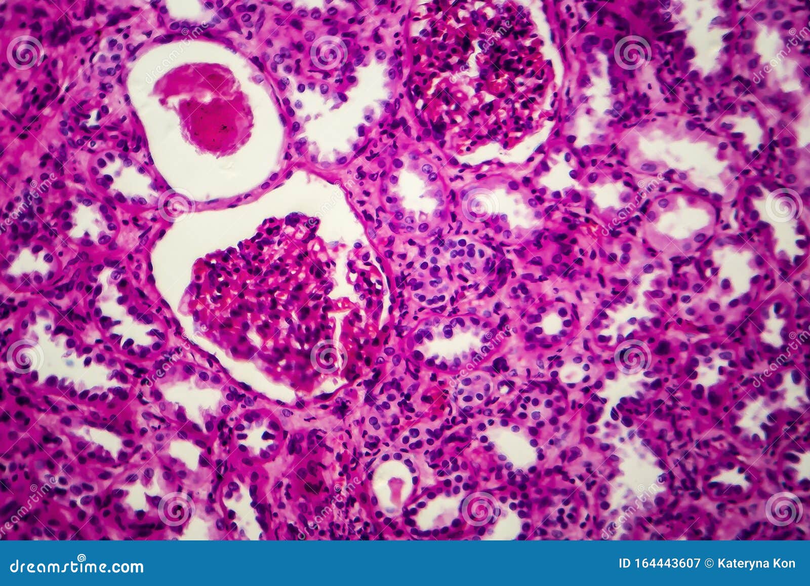 Chronic Pyelonephritis, Light Micrograph Stock Image - Image of ...