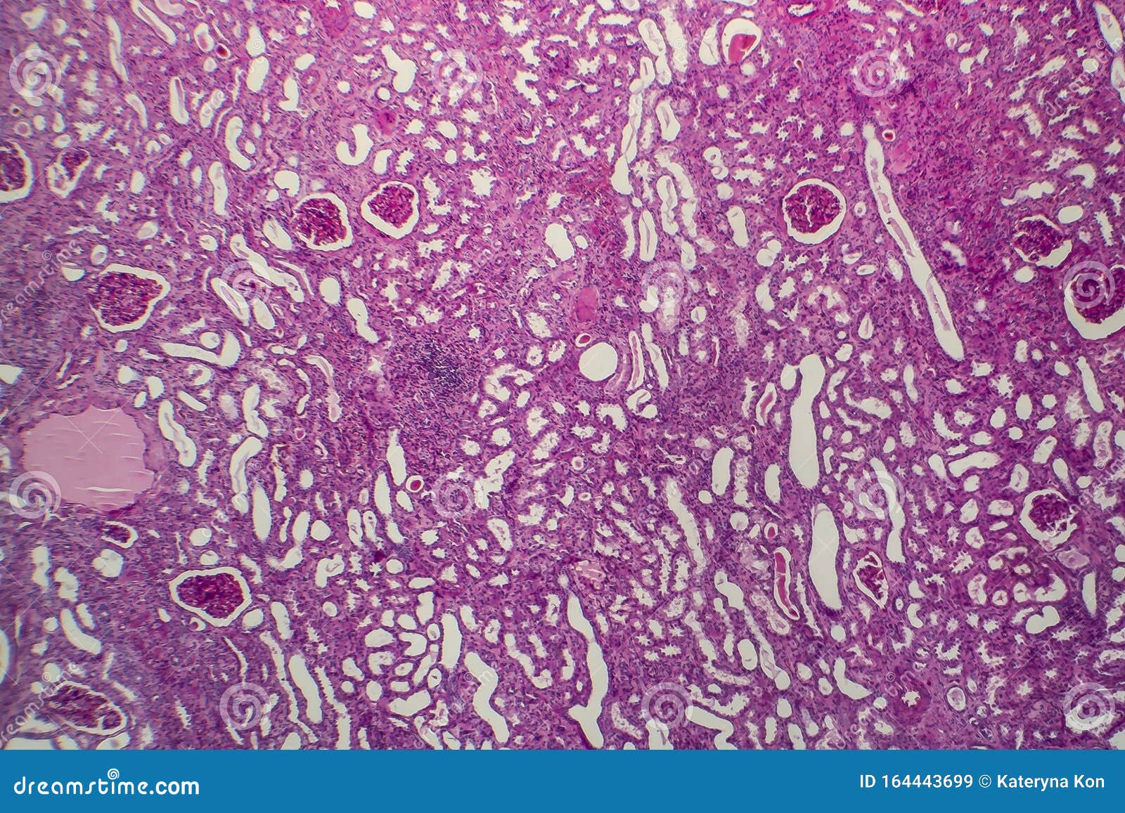 Chronic Pyelonephritis, Light Micrograph Stock Image - Image of tissue ...