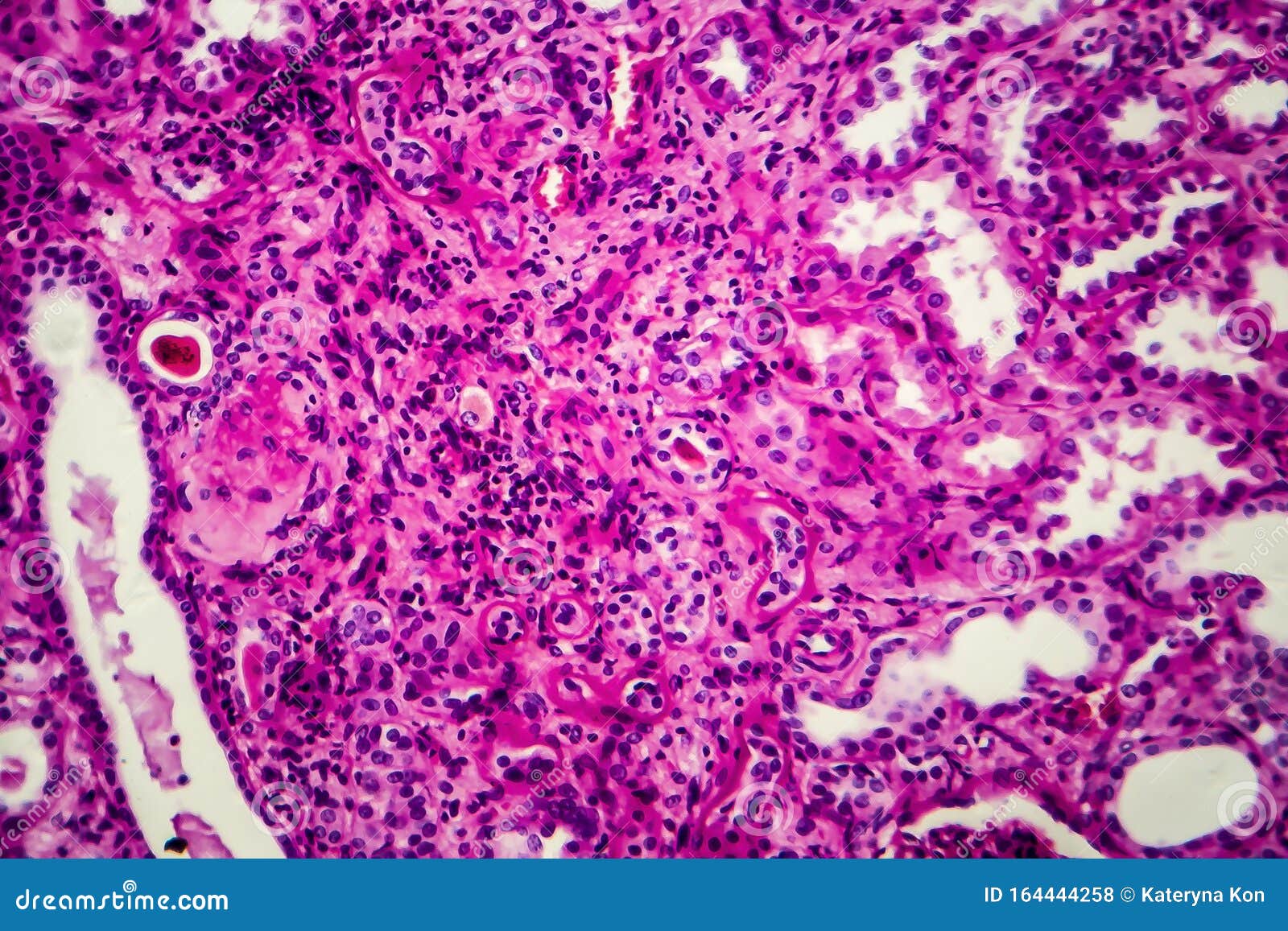 Histopathology Kidneyacute And Chronic Pyelonephritis