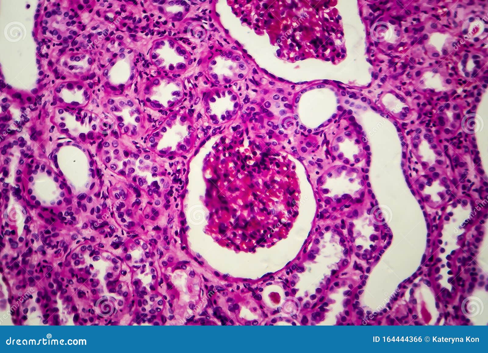 Chronic Pyelonephritis, Light Micrograph Stock Photography ...