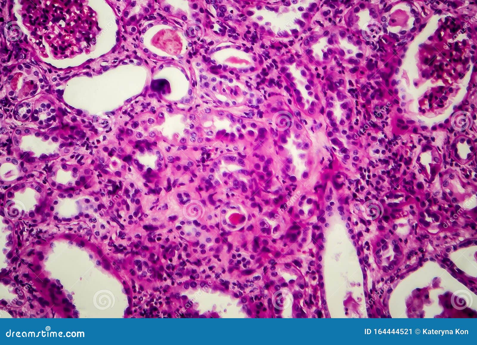 Chronic Pyelonephritis, Light Micrograph Stock Image - Image of kidney ...