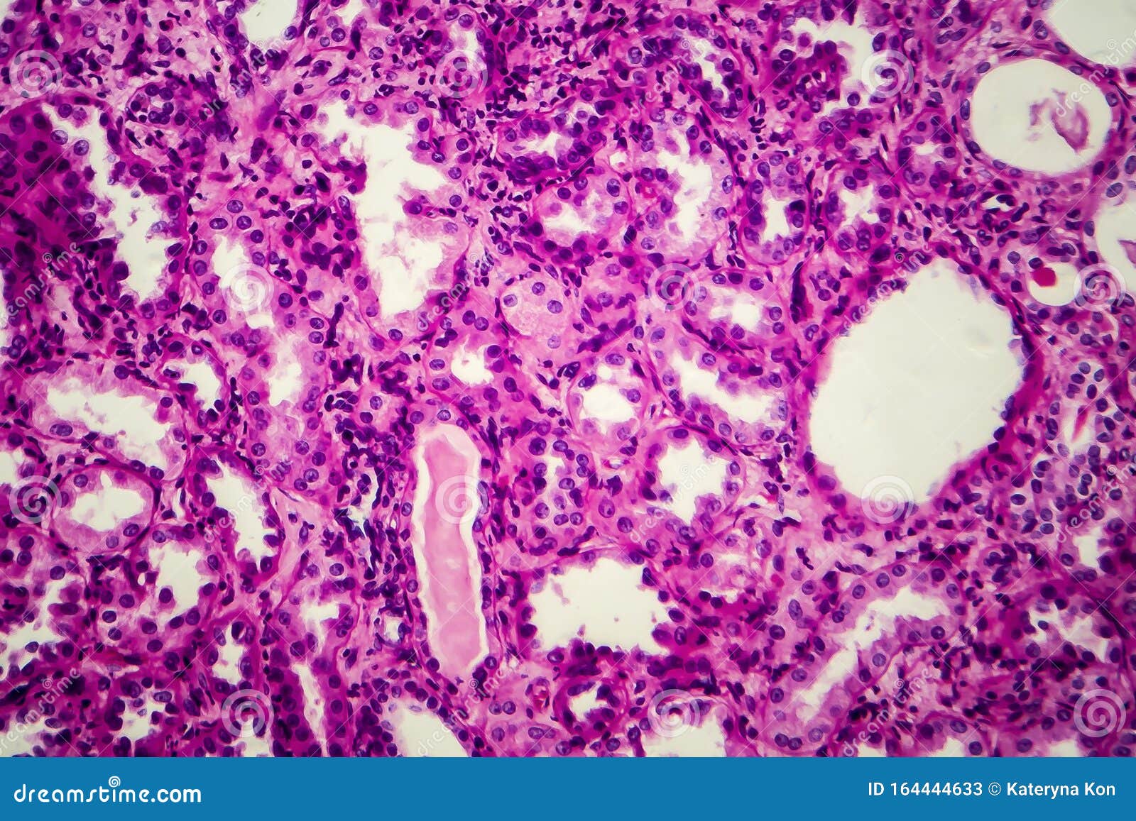Chronic Pyelonephritis, Light Micrograph Stock Image - Image of renal ...