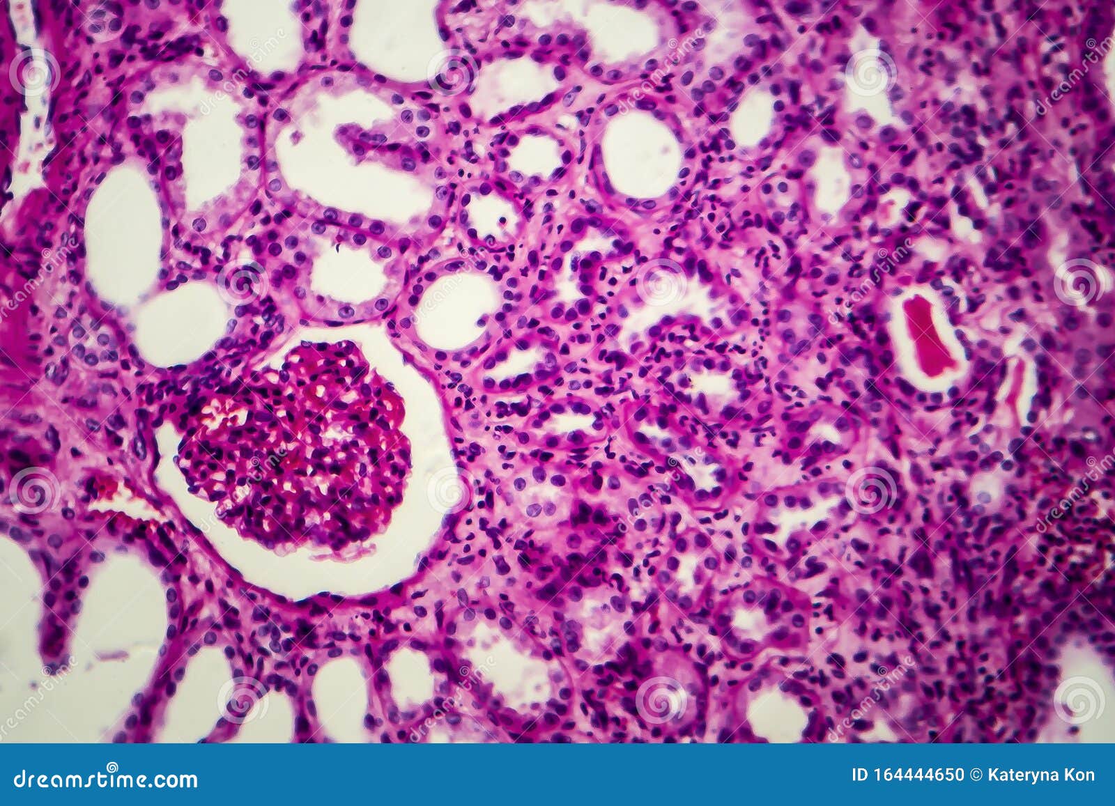 Acute Pyelonephritis