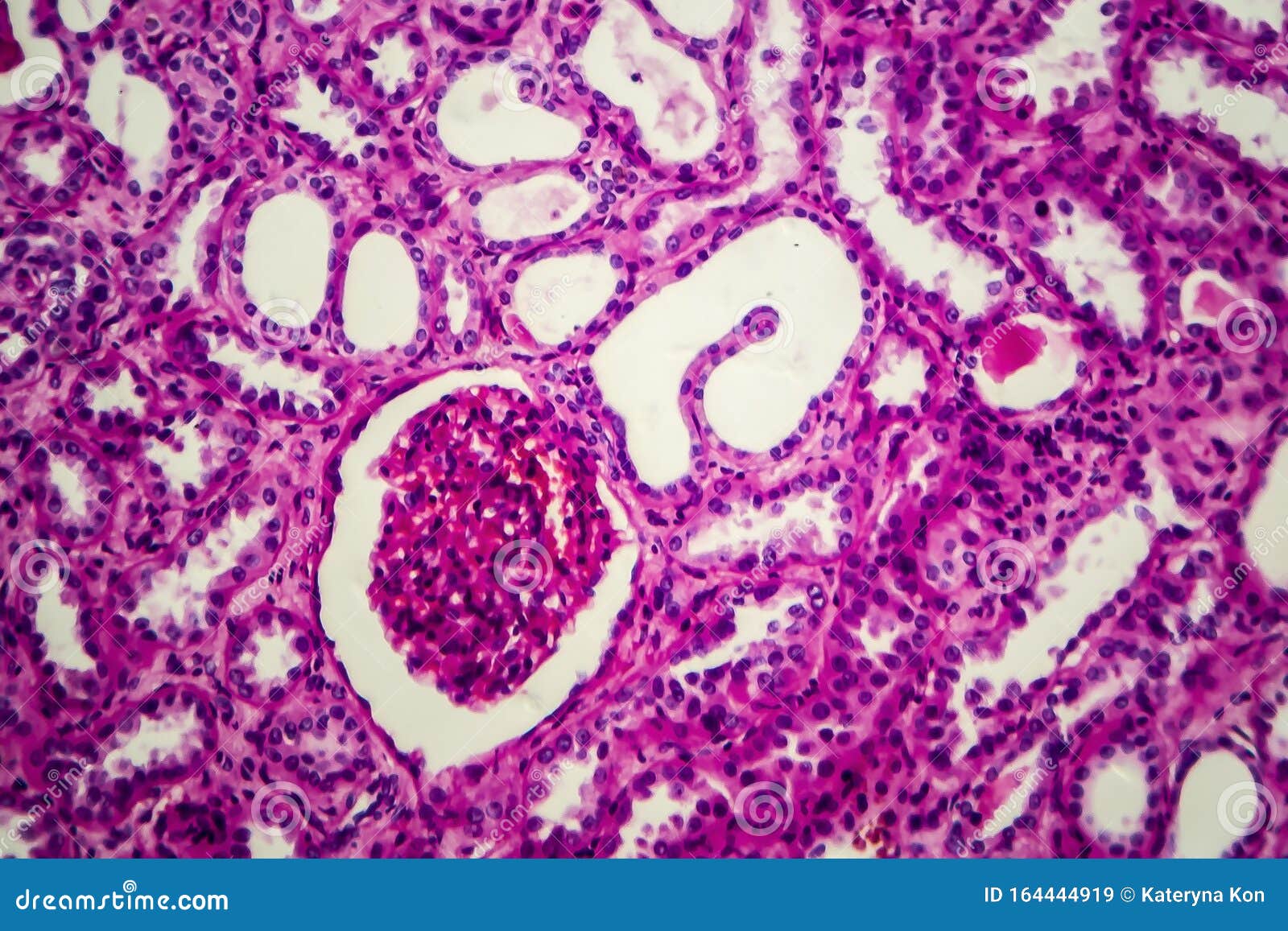 Chronic Pyelonephritis, Light Micrograph Stock Image - Image of kidney ...