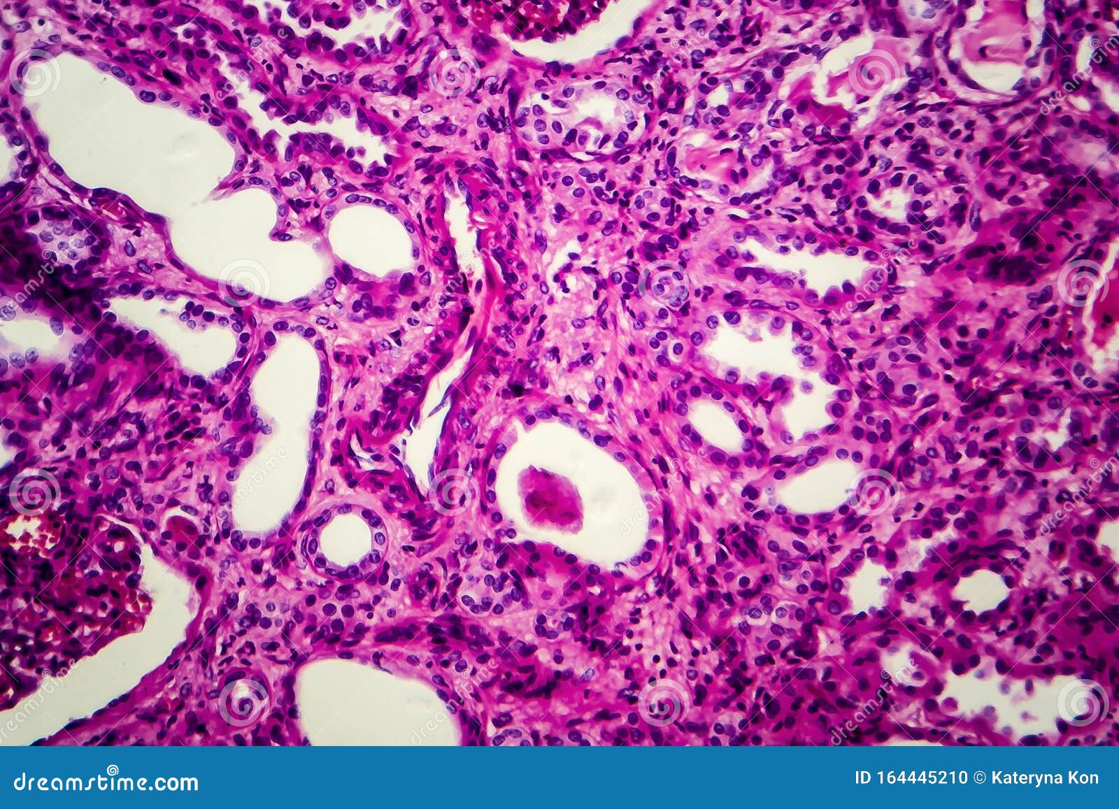 Chronic Pyelonephritis, Light Micrograph Stock Photo - Image of tissue ...