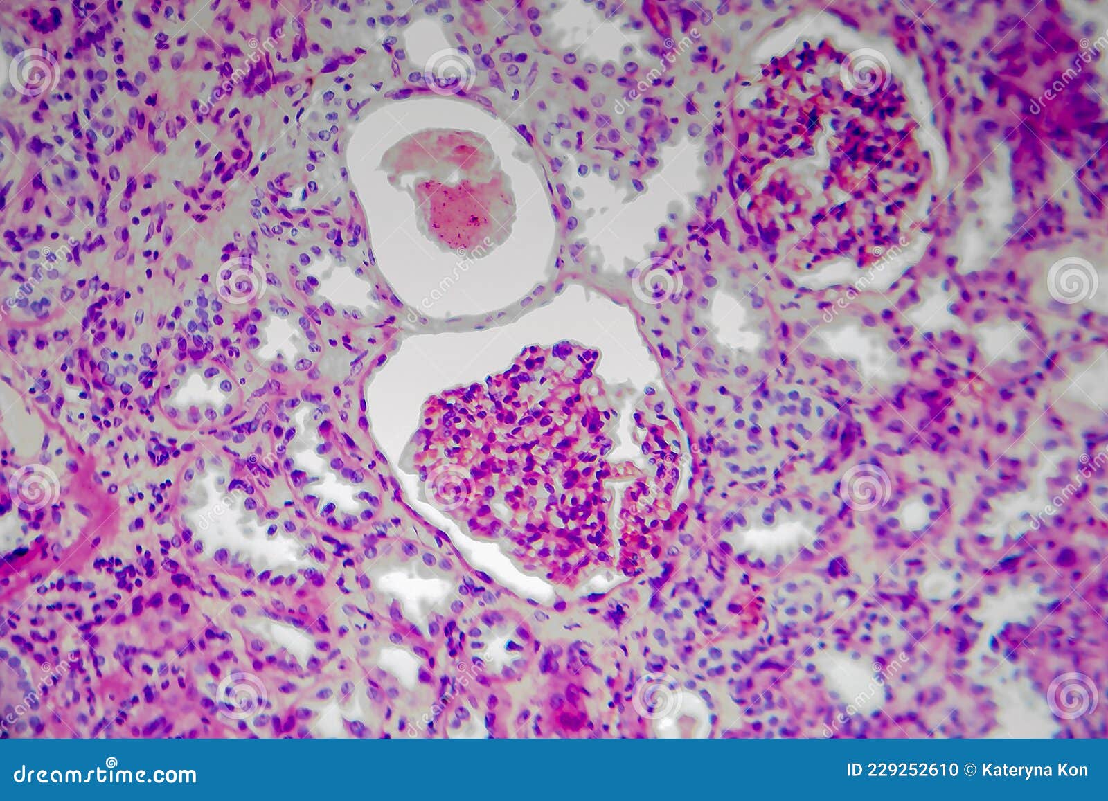 Chronic Pyelonephritis, Light Micrograph Stock Photo - Image of eosin ...