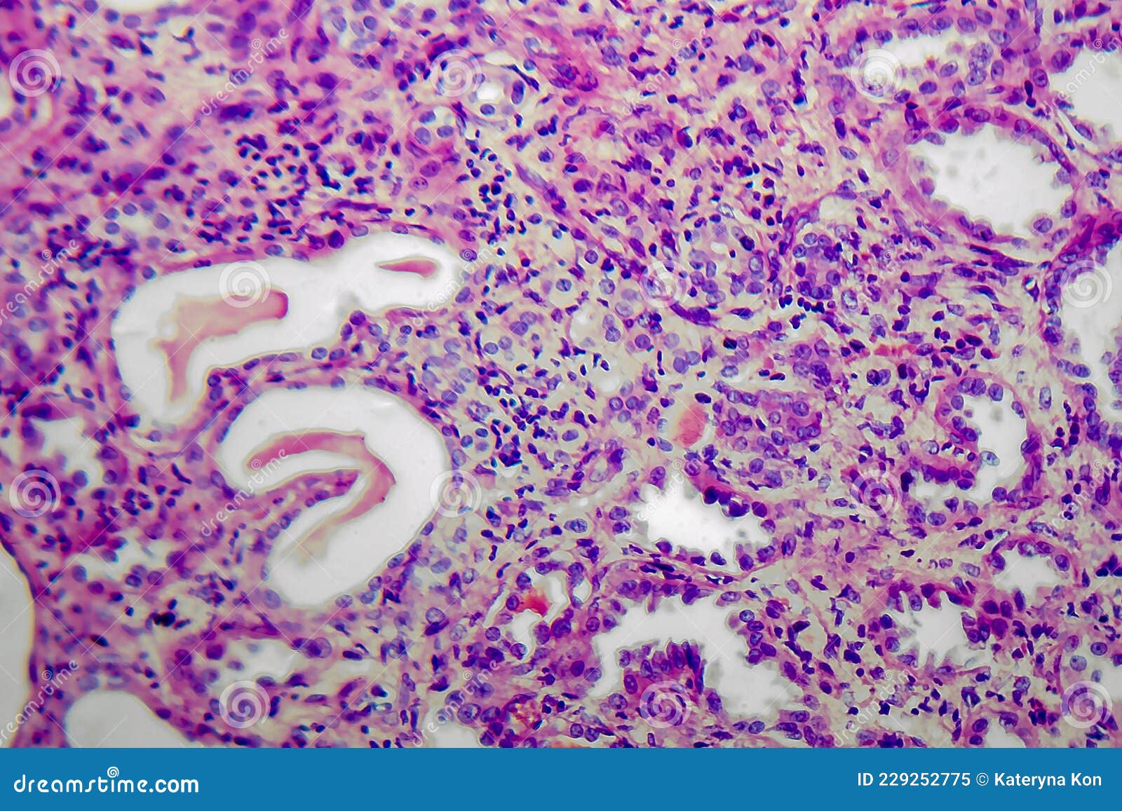 Chronic Pyelonephritis, Light Micrograph Stock Image - Image of ...