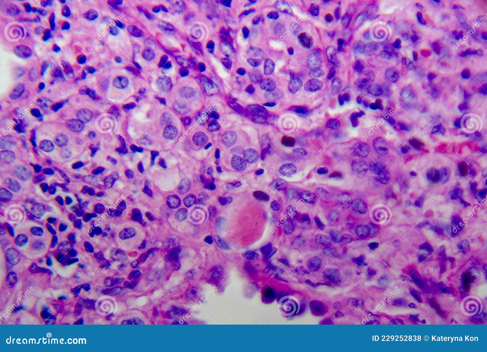 Chronic Pyelonephritis, Light Micrograph Stock Photo - Image of ...