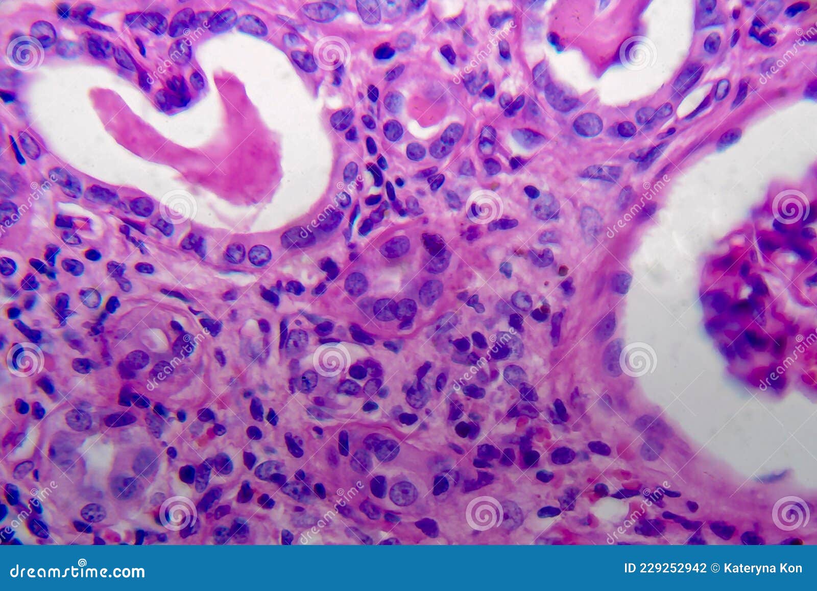 Chronic Pyelonephritis, Light Micrograph Stock Photo - Image of ...