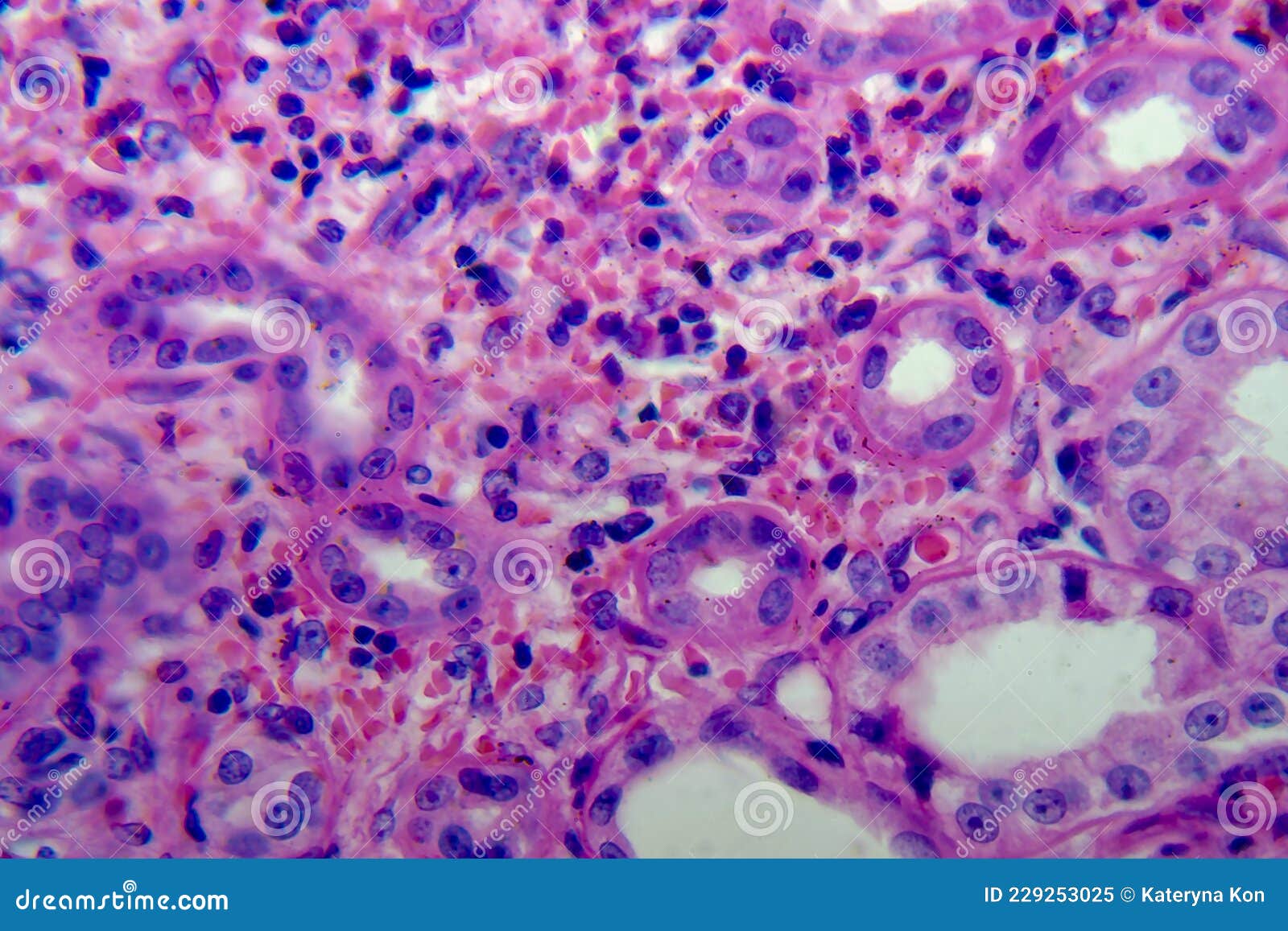 Chronic Pyelonephritis, Light Micrograph Stock Image - Image of illness ...