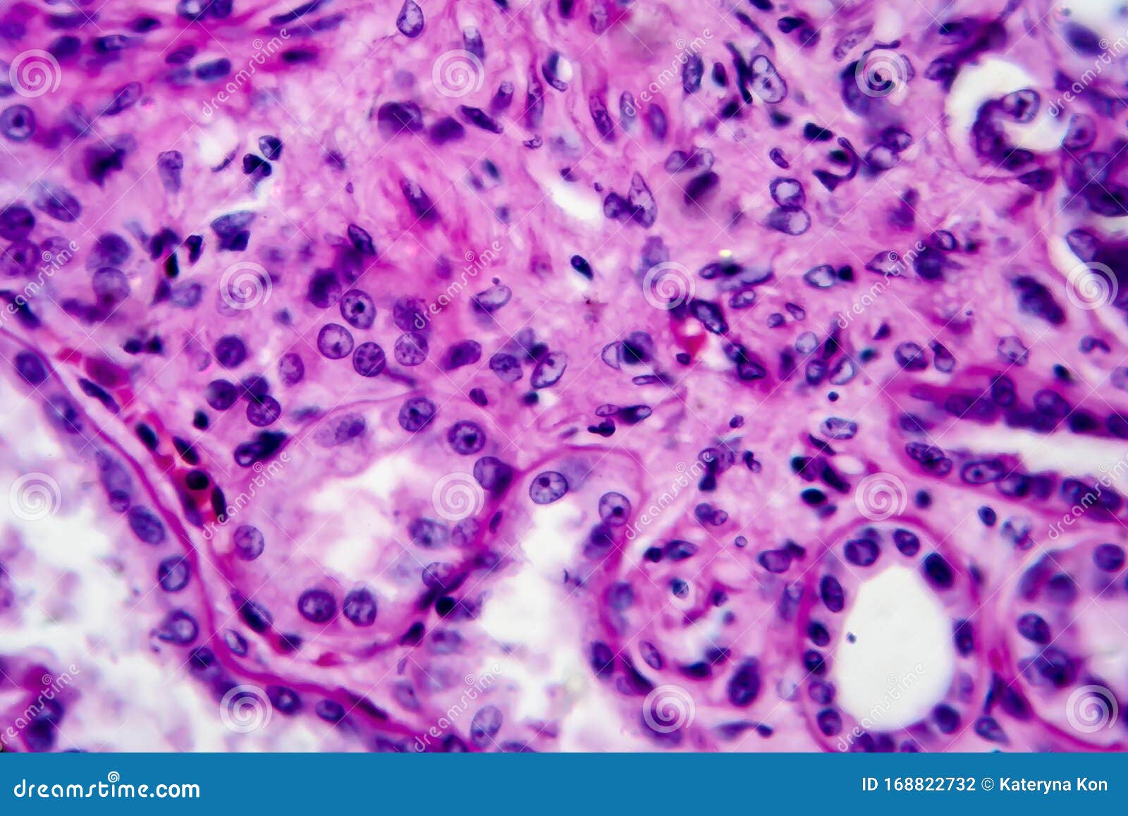 Chronic Pyelonephritis, Light Micrograph Stock Photo - Image of ...