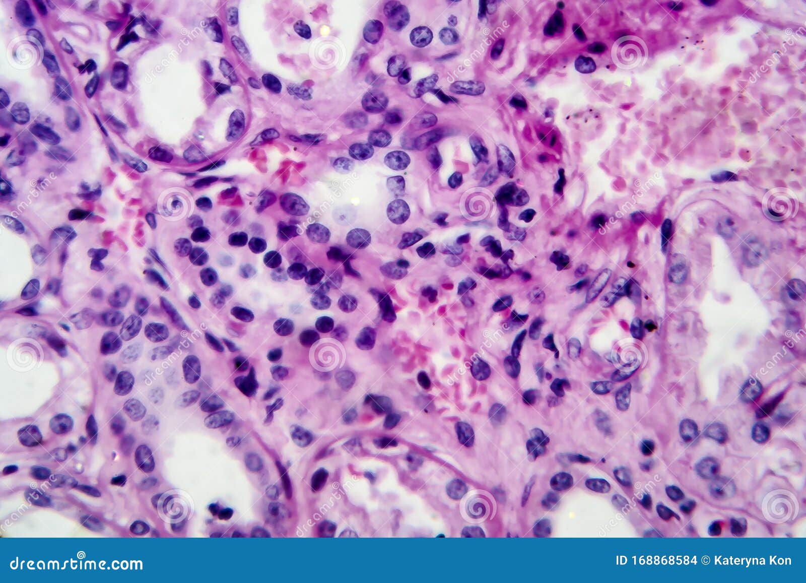 Chronic Pyelonephritis, Light Micrograph Stock Photo - Image of ...