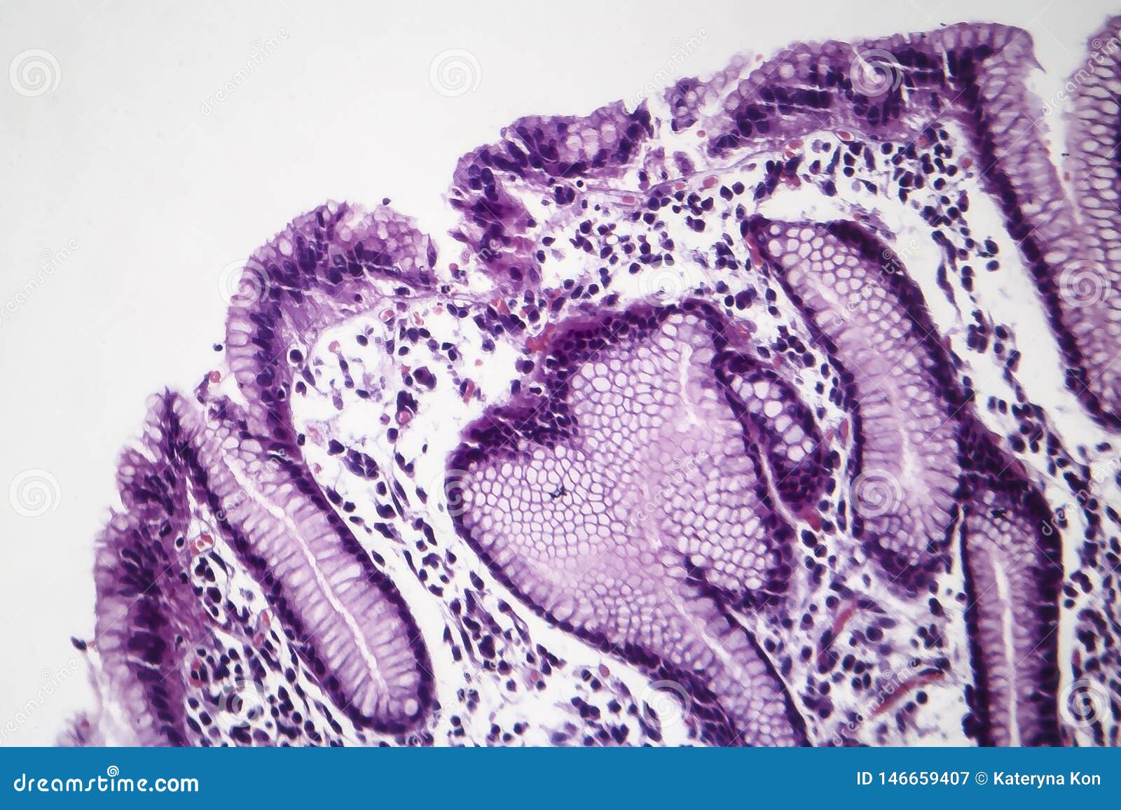 Chronic Superficial Gastritis, Light Micrograph Stock Illustration ...