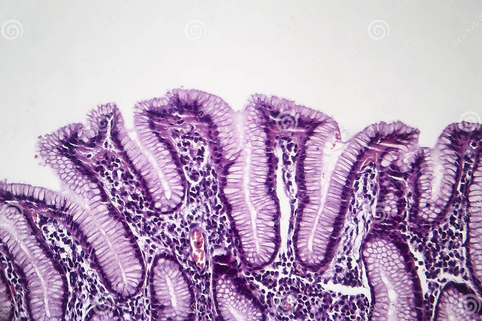 Chronic Superficial Gastritis, Light Micrograph Stock Illustration ...