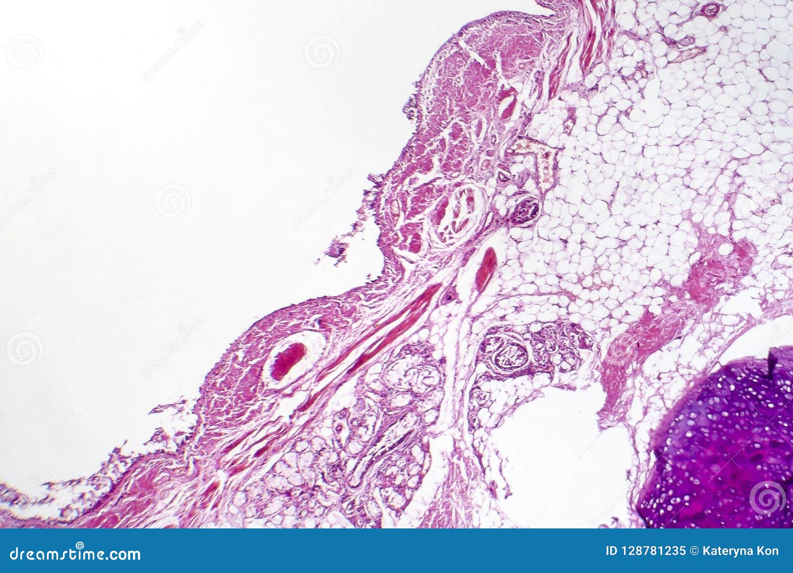 Chroniczny Bronchit Pod Mikroskopem Obraz Stock - Obraz złożonej z ...