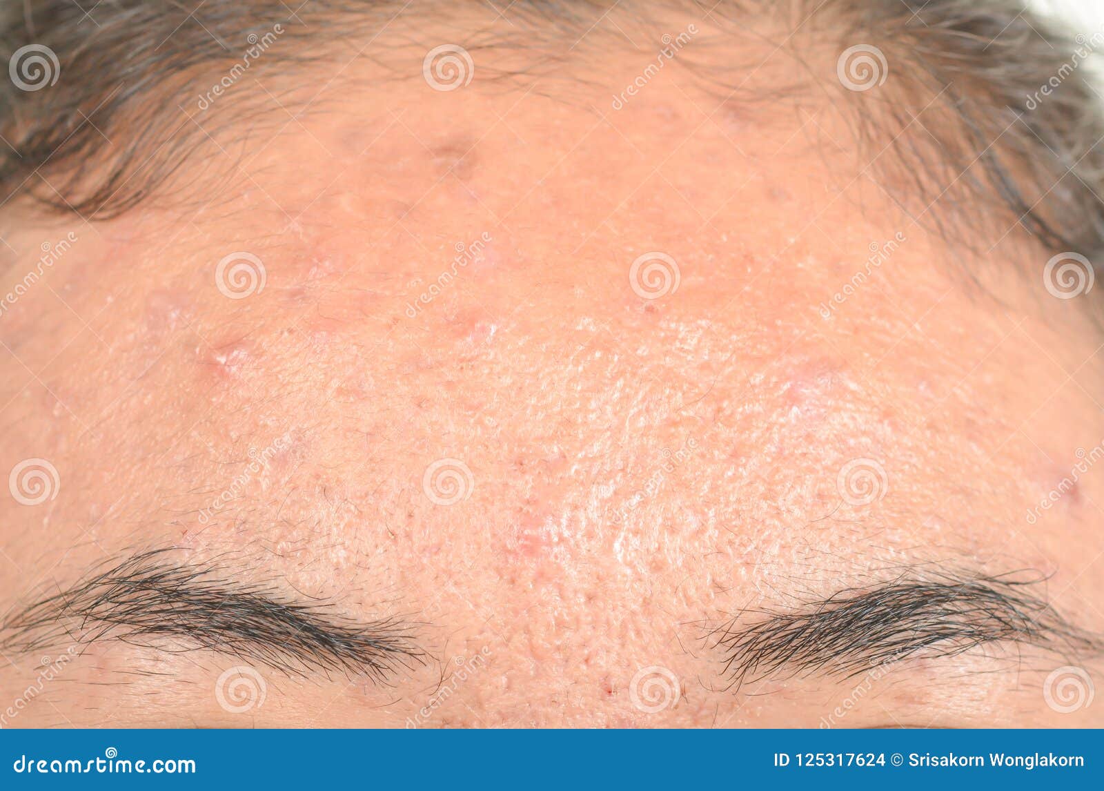 Cicatrice De L'acné Sur Le Visage Photo stock - Image du problème ...