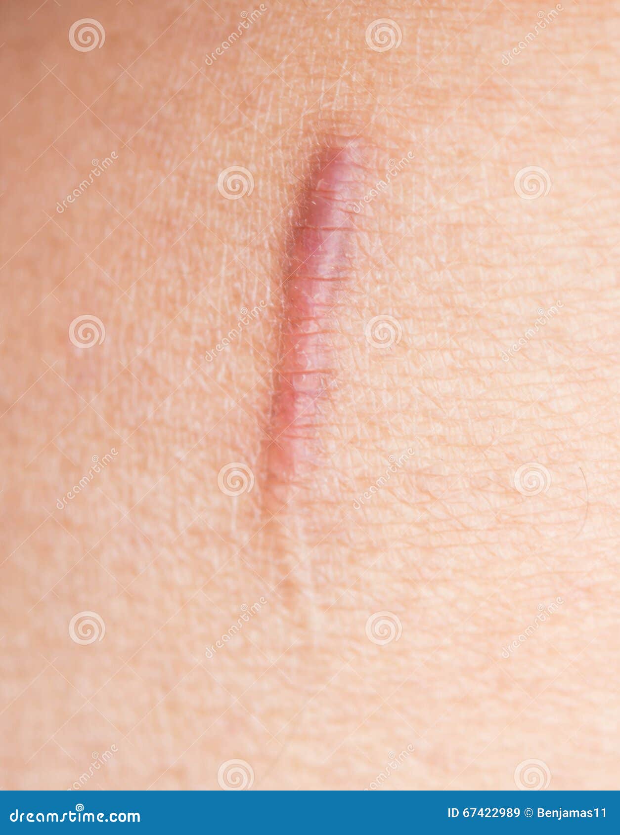 Cicatrices image stock. Image du cicatrice, cruel, peau - 67422989