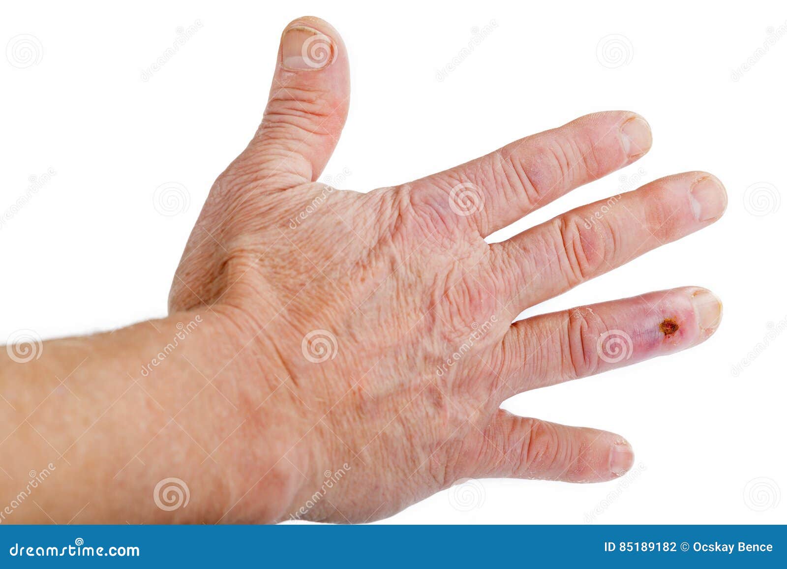 Cicatriz Postoperatoria En El Cuarto Finger Foto de archivo - Imagen de ...