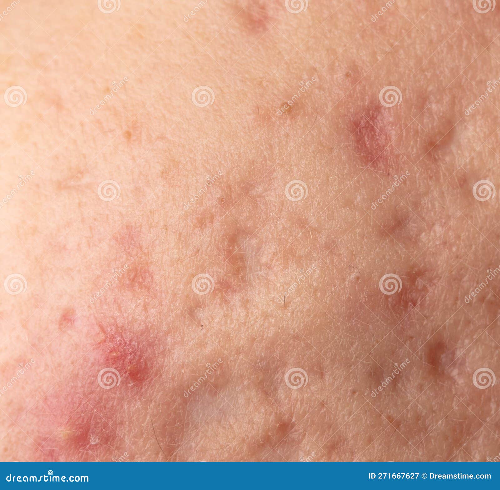 Cicatrizes De Acne Na Pele. Macro Imagem de Stock - Imagem de problema ...