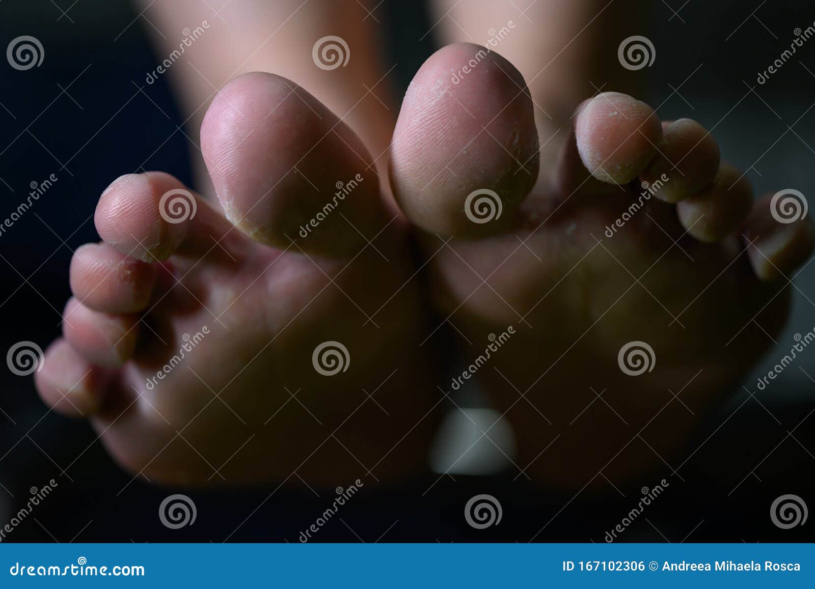 Cierre De Los Pies De La Mujer Con Tinea Pedis Althlete Infección Por