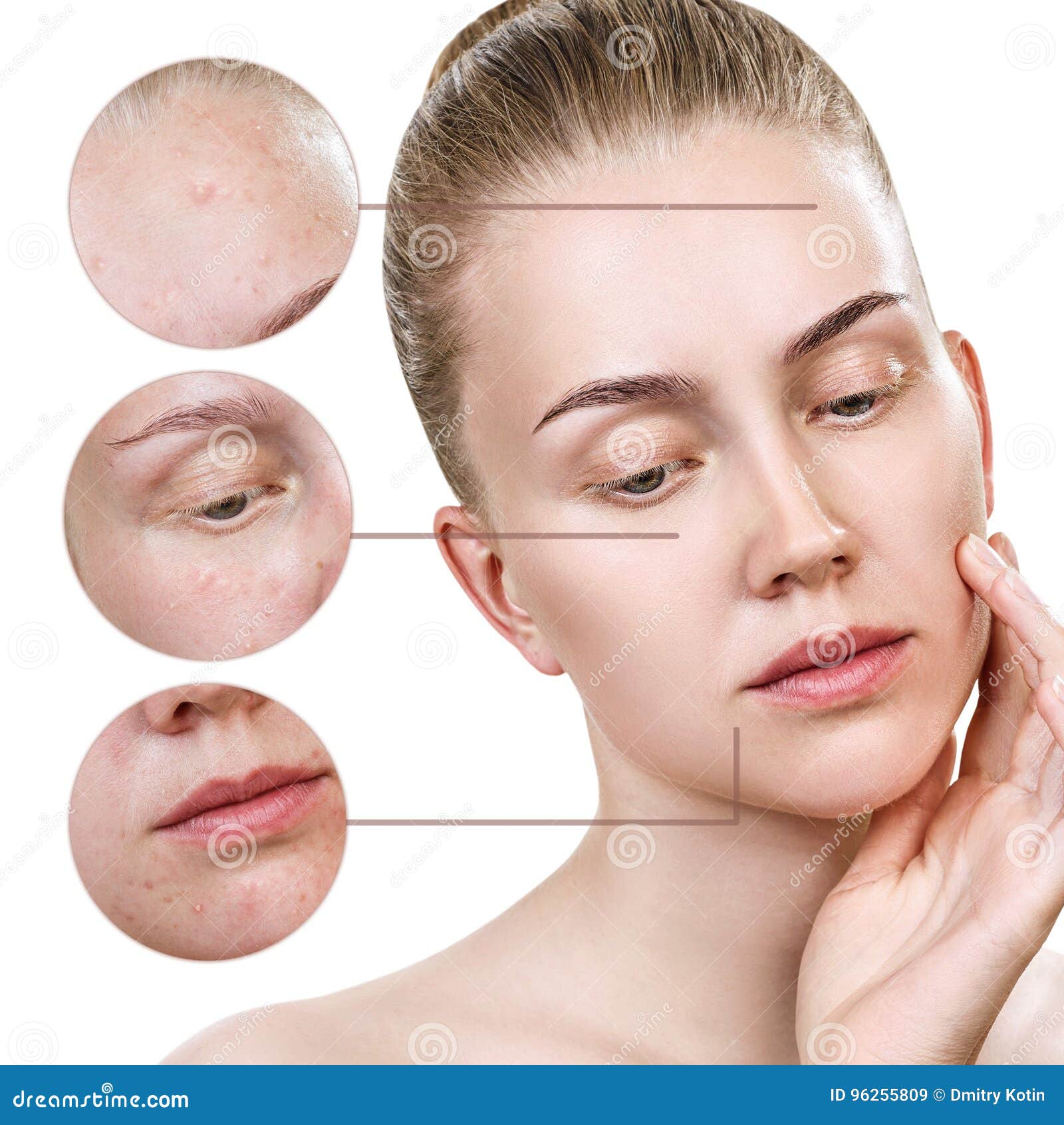 Circles Shows Problem Skin of Young Woman. Stock Image - Image of ...