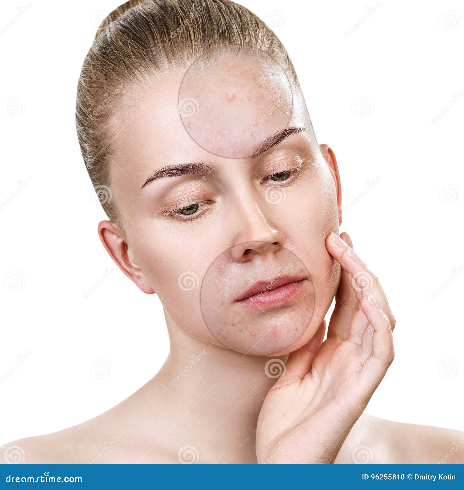 Circles Shows Problem Skin of Young Woman. Stock Photo - Image of ...