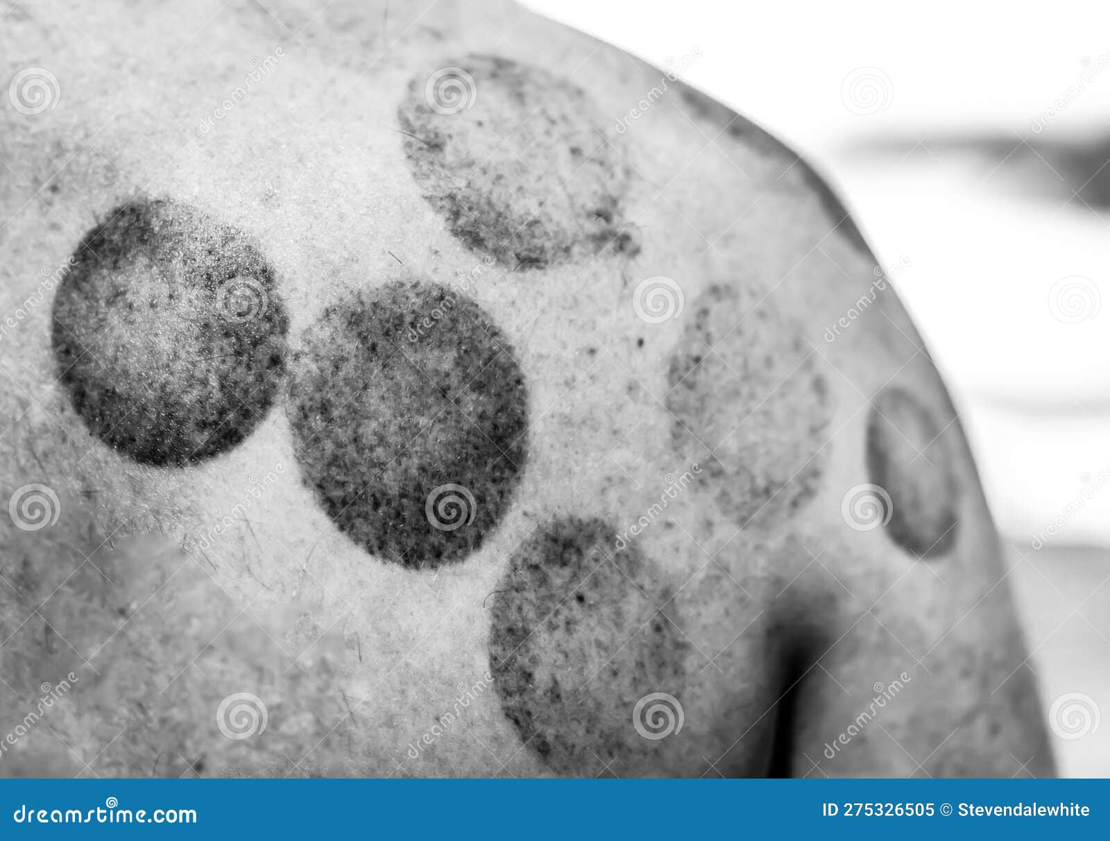 Circular Bruises on a Back and Shoulder after Cupping Therapy Stock ...