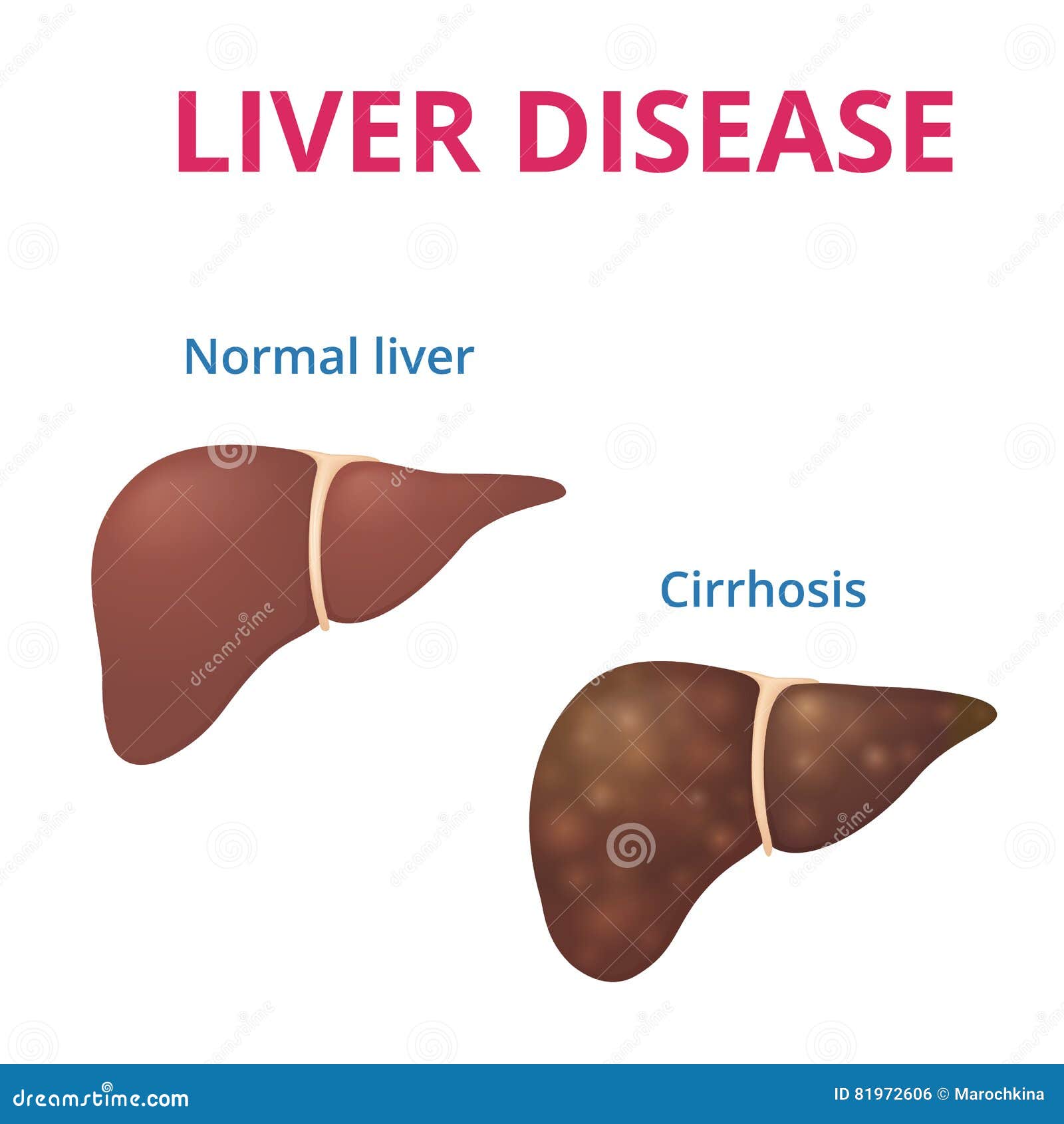 Cirrhose hépatique illustration de vecteur. Illustration du infecté ...