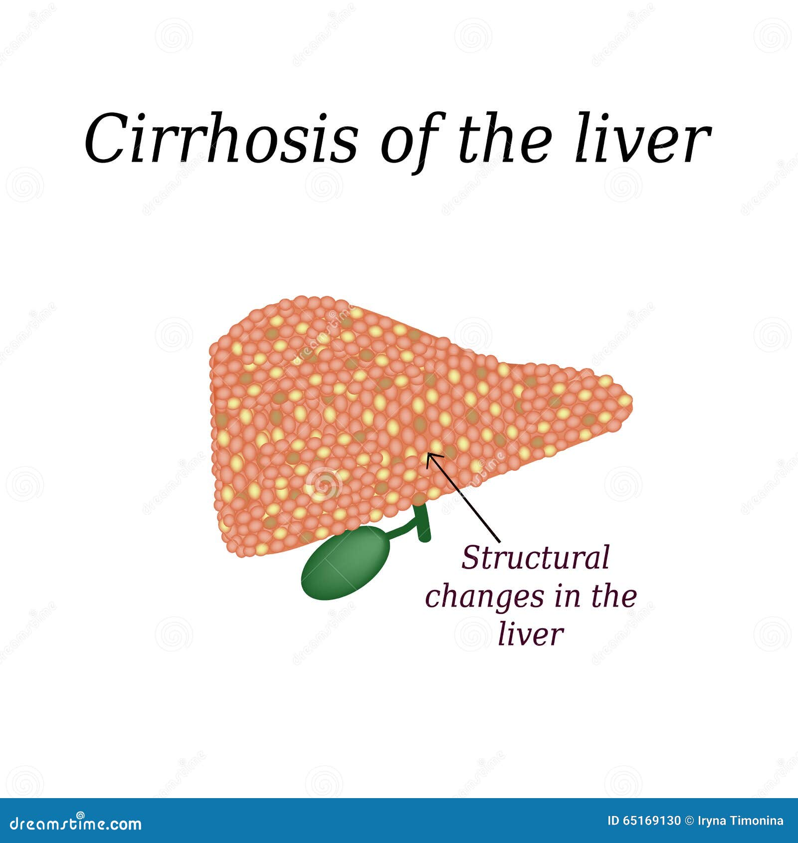 Cirrhosis of the Liver. Vector Illustration on Background Stock Vector ...