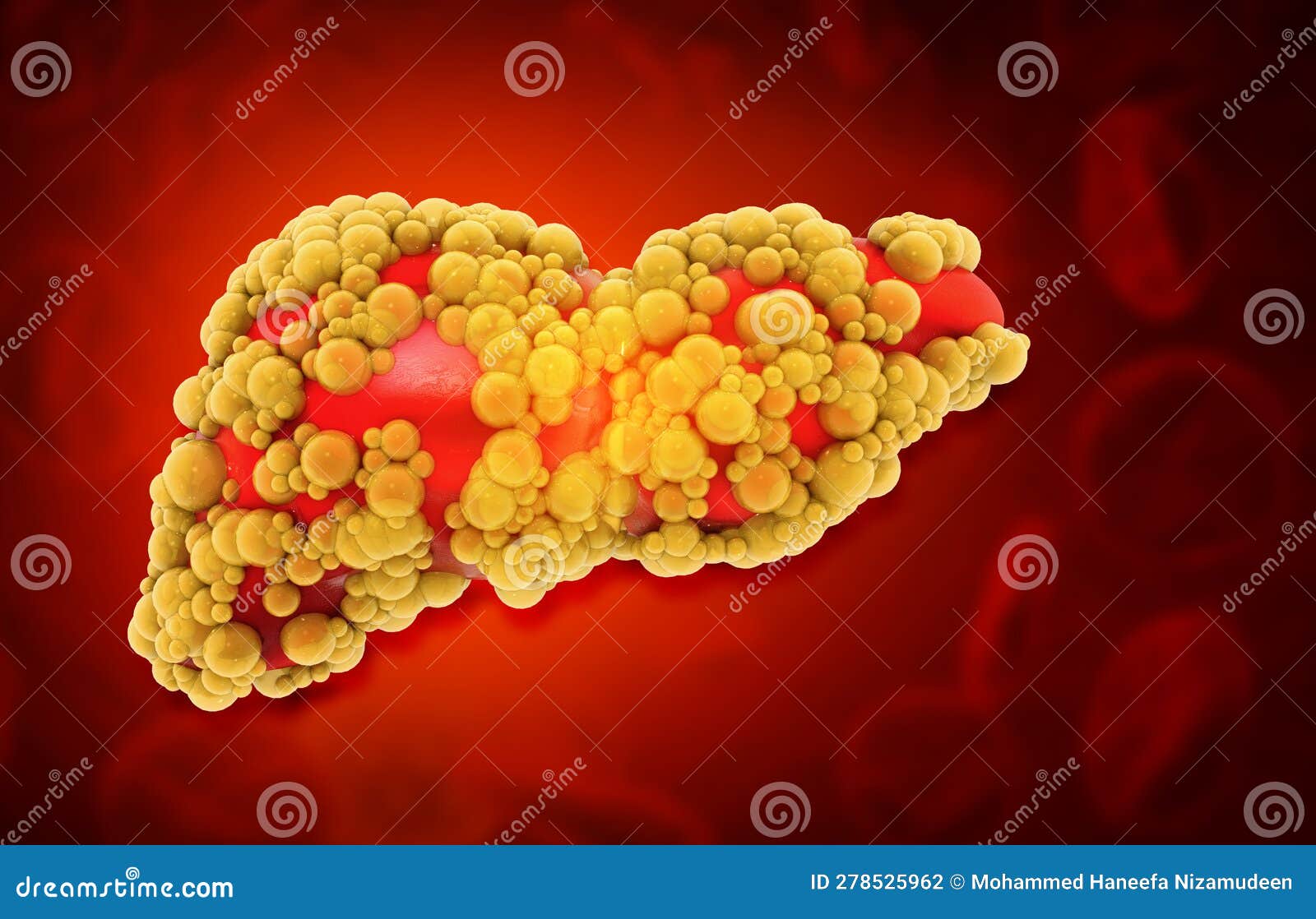 Cirrosi Epatica. Malattia Epatica Illustrazione di Stock ...