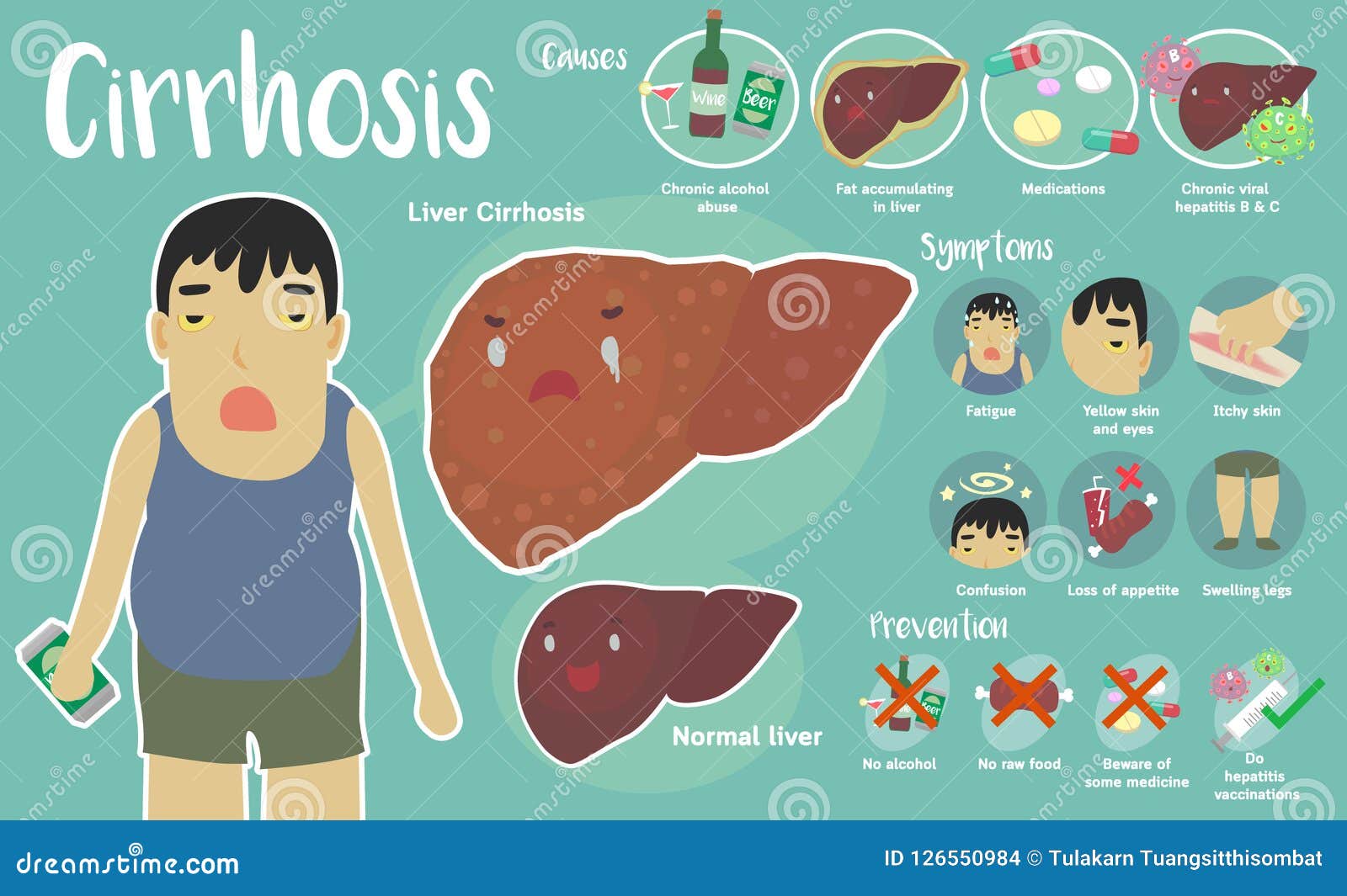 Cirrosis infographic ilustración del vector. Ilustración de agudo ...