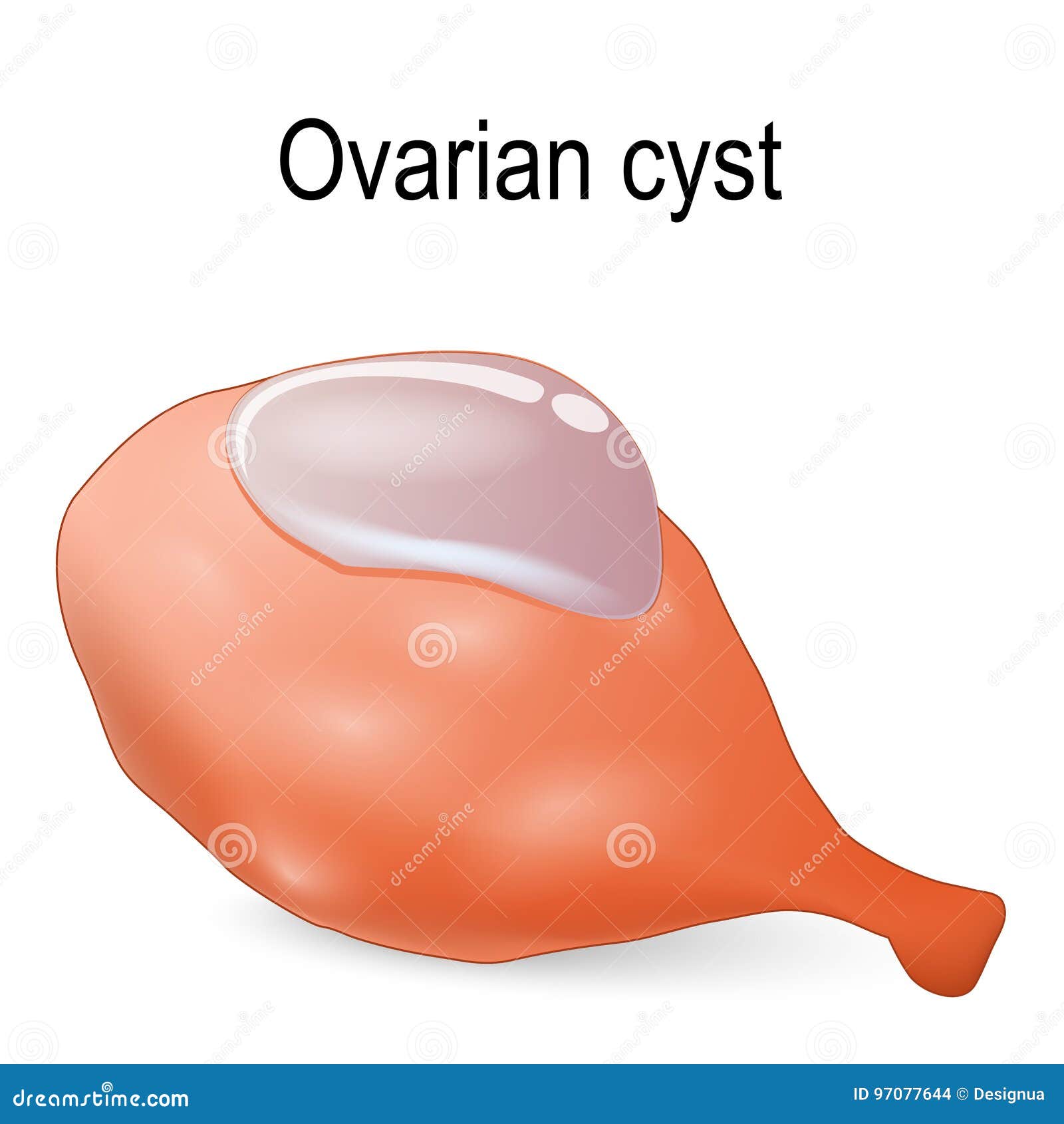 Ciste ovarica illustrazione vettoriale. Illustrazione di illustrazione ...