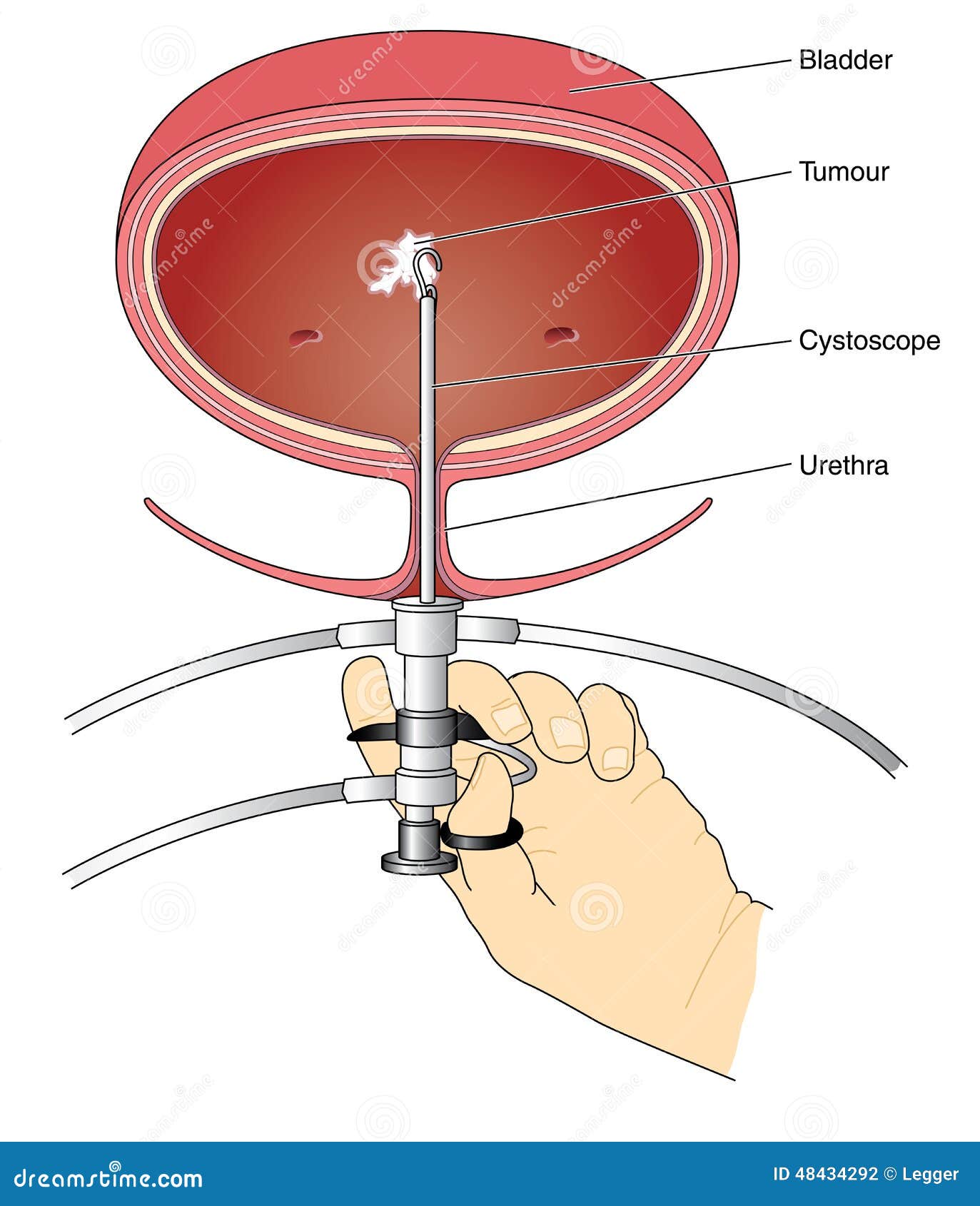 Cistoscopia della vescica illustrazione vettoriale. Illustrazione di ...