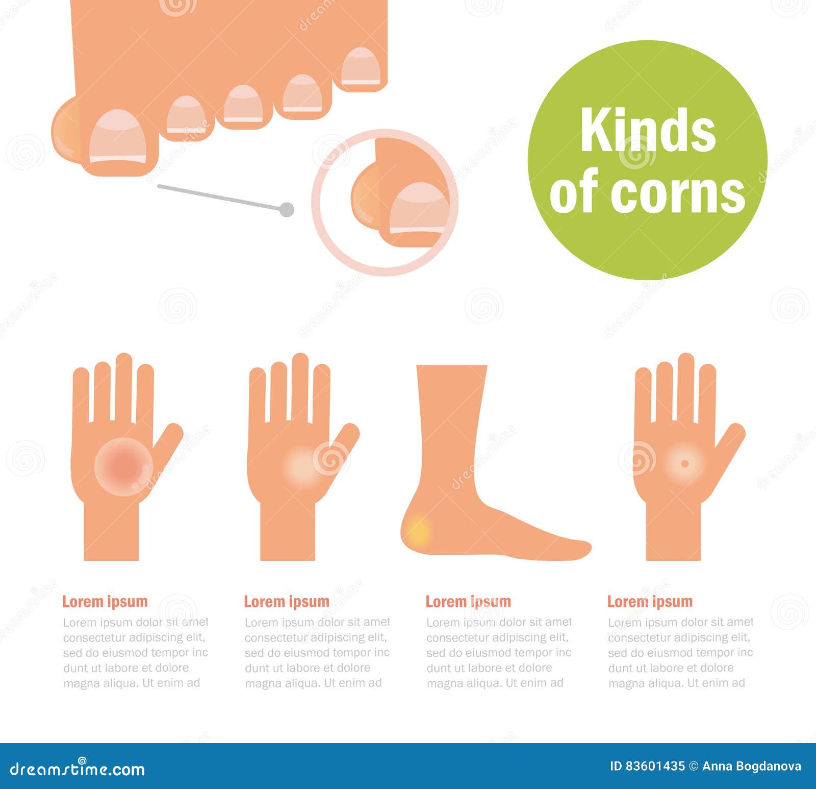 Clases De Granos Callosidad, Ilustración del Vector - Ilustración de ...