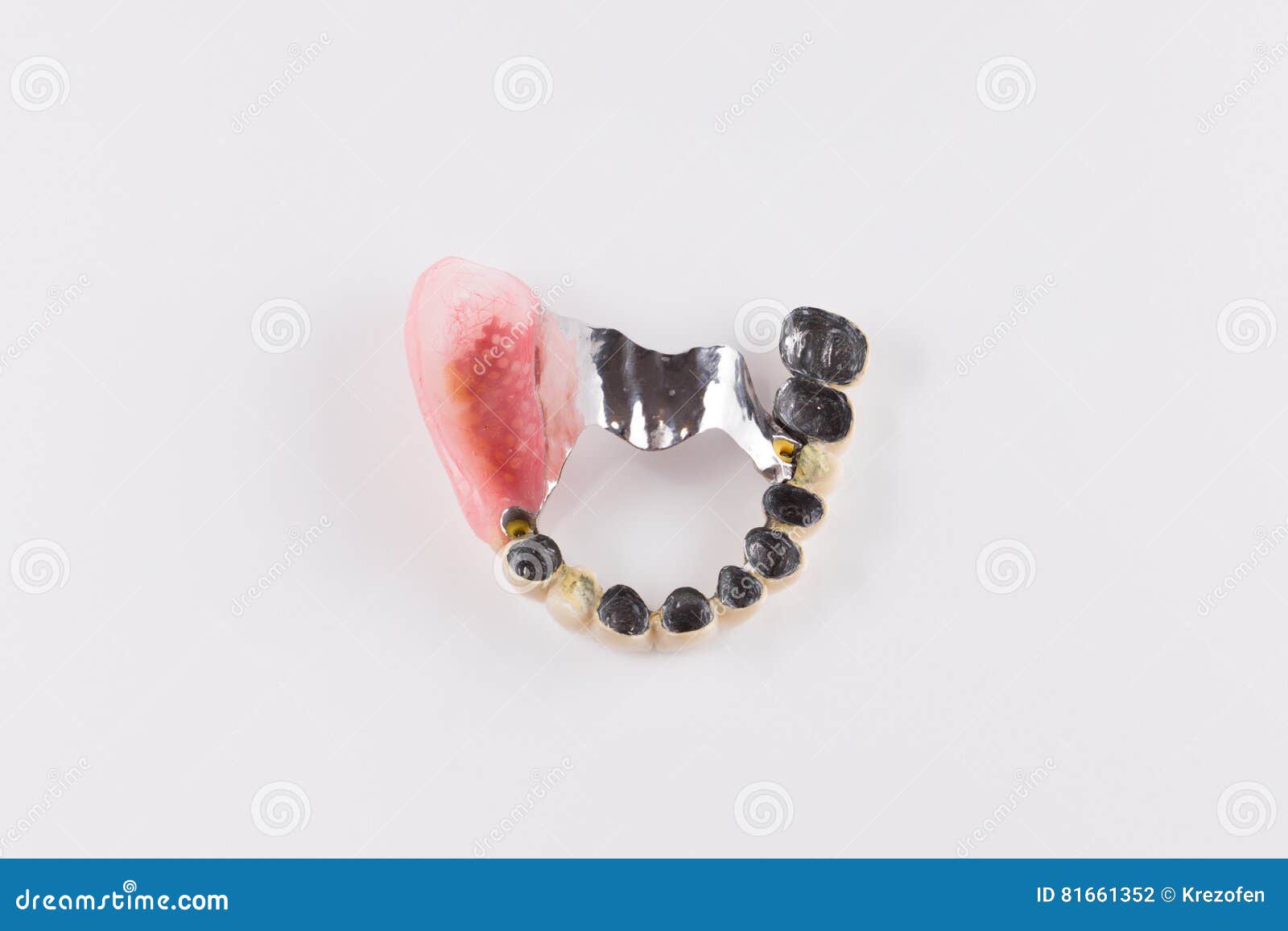 Clasp Prosthesis with Attachments Fixing Ceramic Crowns Stock Photo ...