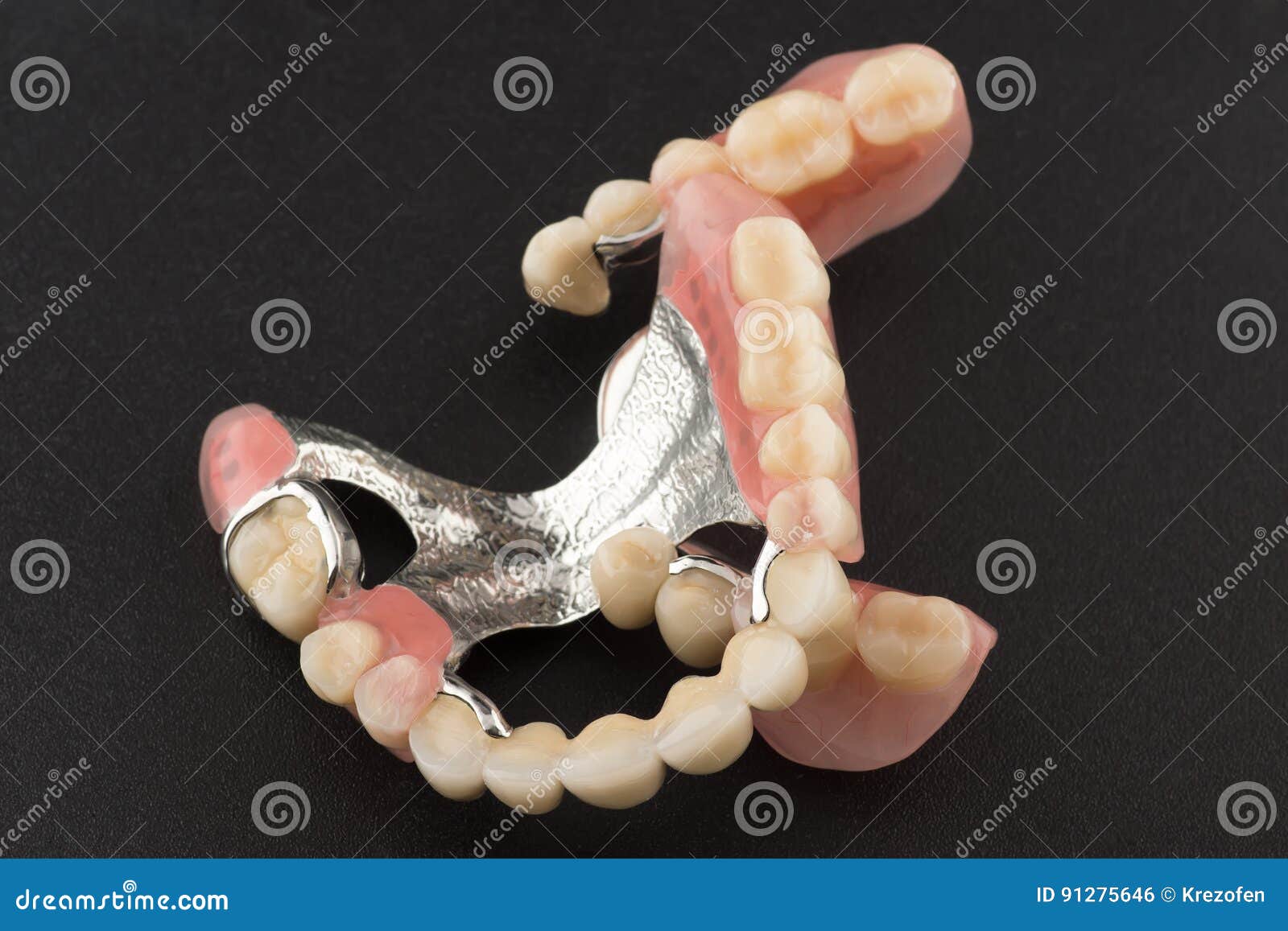 Clasp Prosthesis with Lock Fixation Stock Photo - Image of metal ...