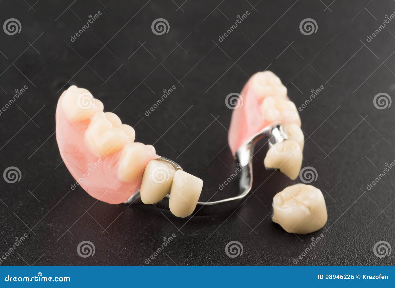Clasp Prosthesis with Lock Fixation Stock Photo - Image of equipment ...