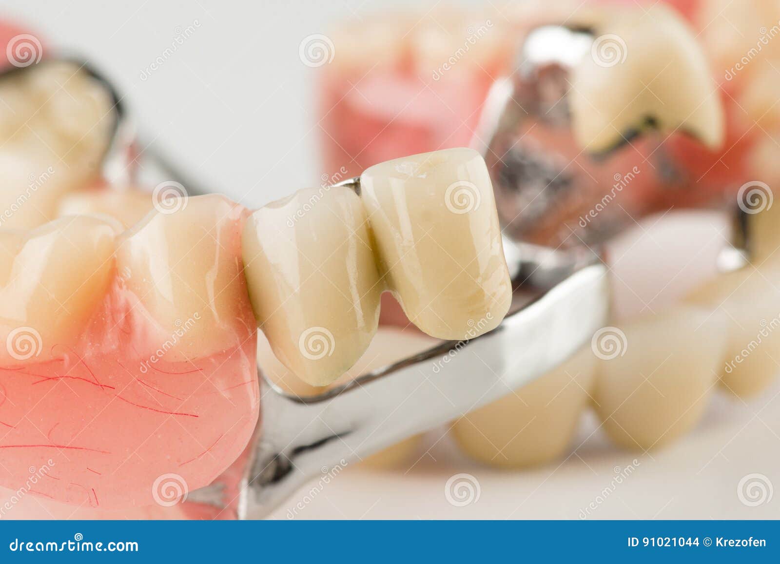 Clasp Prosthesis with Lock Fixation Stock Photo - Image of ceramics ...