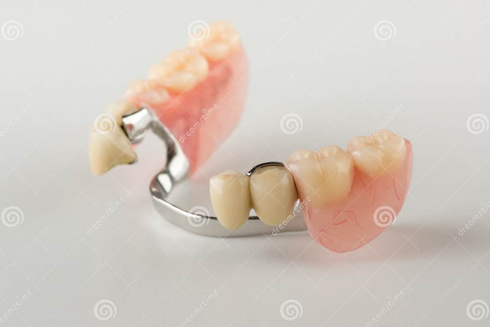Clasp Prosthesis with Lock Fixation Stock Photo - Image of close ...